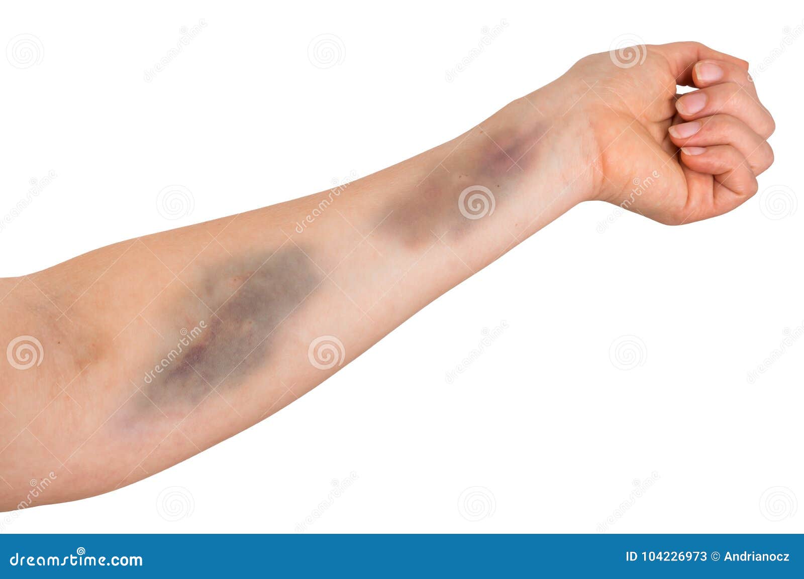 Grande Contusion Sur Le Bras Humain Image stock - Image du cicatrice ...