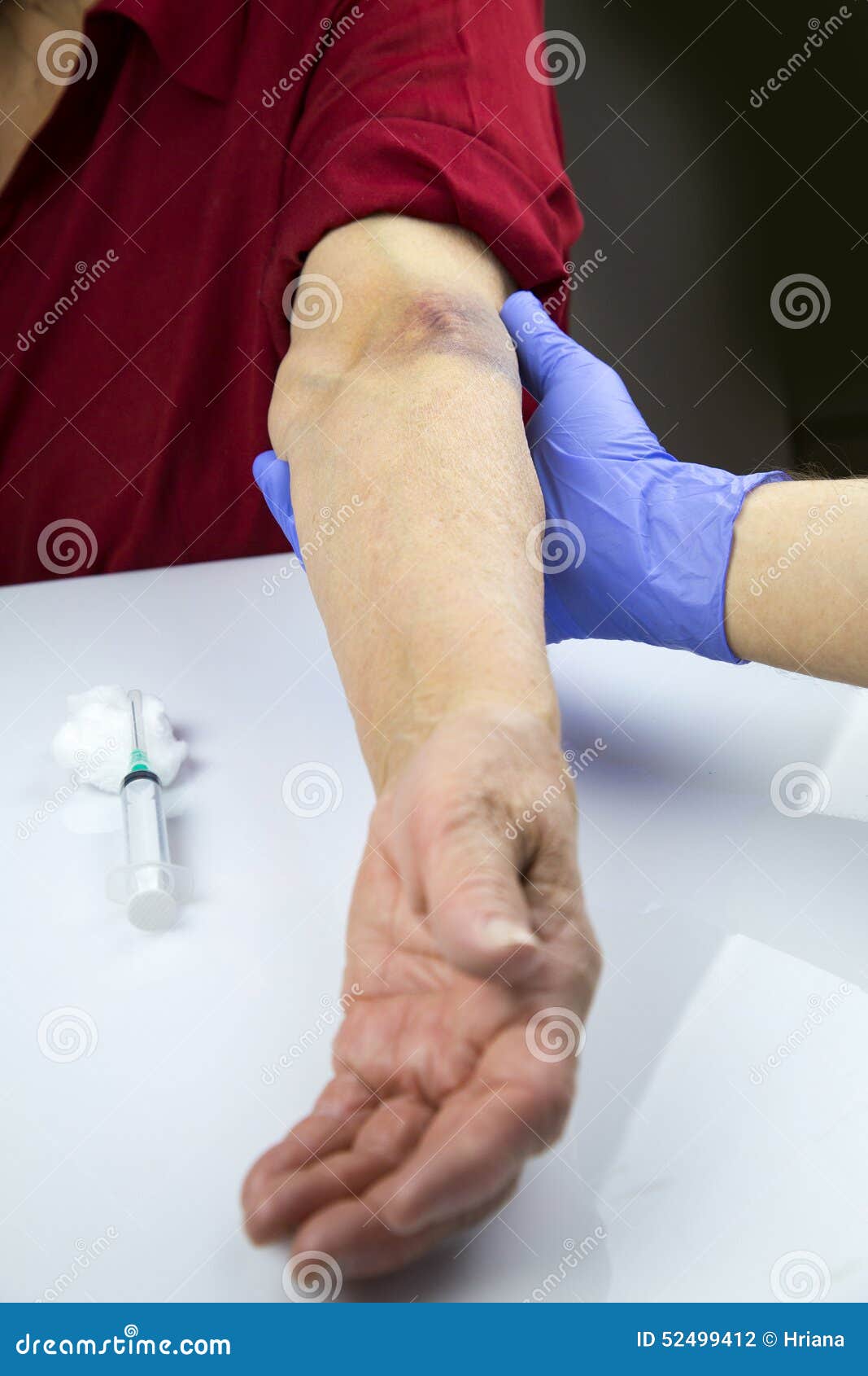 Grande Contusion Sur Le Bras Humain Photo stock - Image du docteur ...