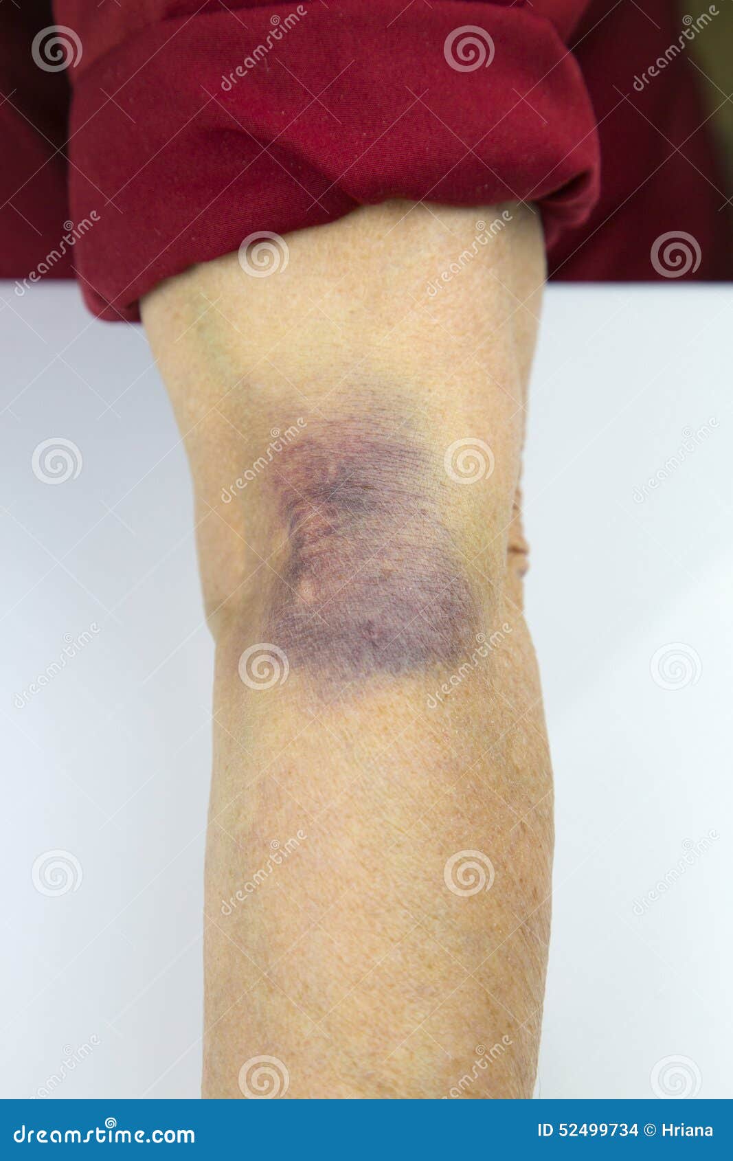 Grande Equimose No Braço Humano Foto de Stock - Imagem de médico ...