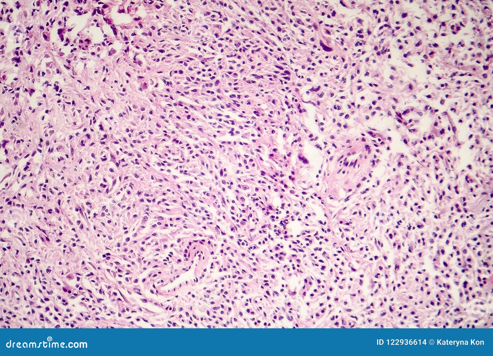 Granuloma Del Cuerpo Extraño Foto de archivo - Imagen de tejido ...