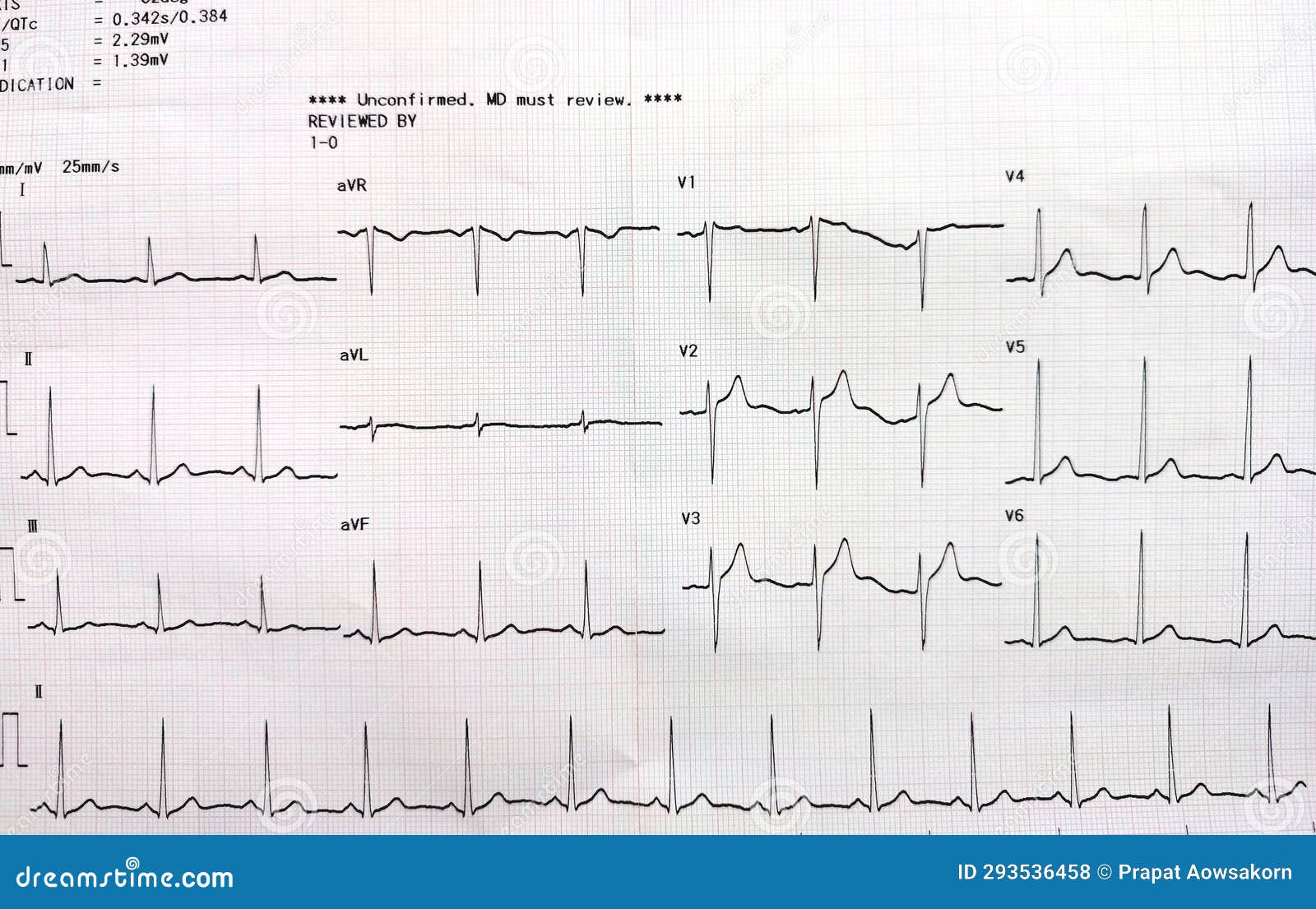 Graph Showing the Results of the Electrocardiogram (EKG) Test on ...