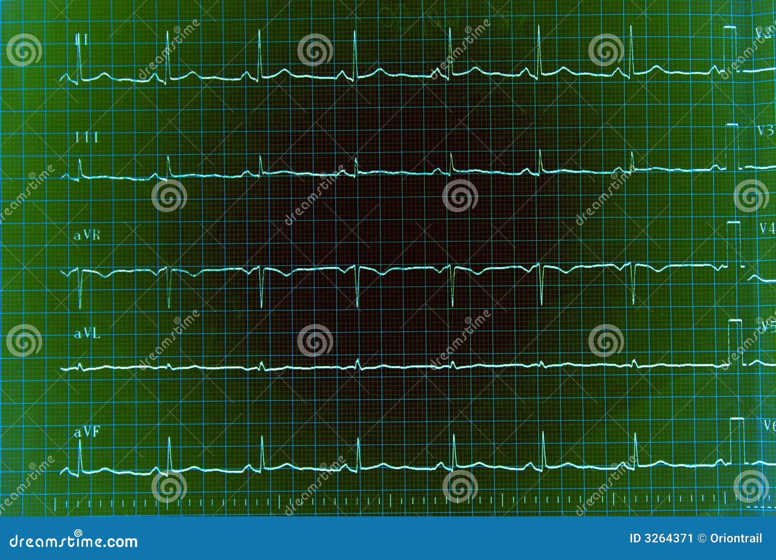 117 Graphique Normal Du Battement De Coeur Ecg Photos libres de droits ...