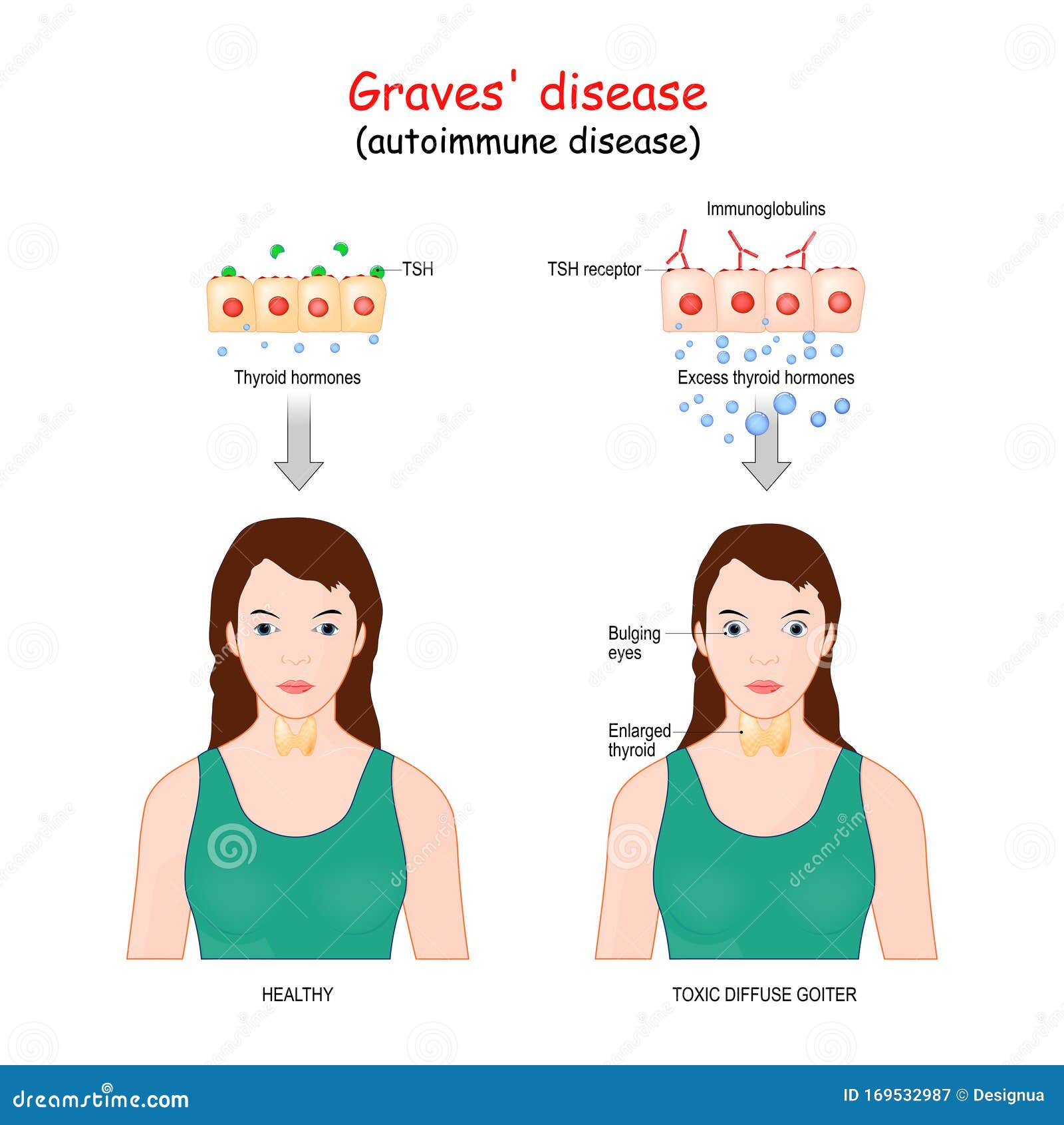 Graves` Disease Toxic Diffuse Goiter Is An Autoimmune Disease That