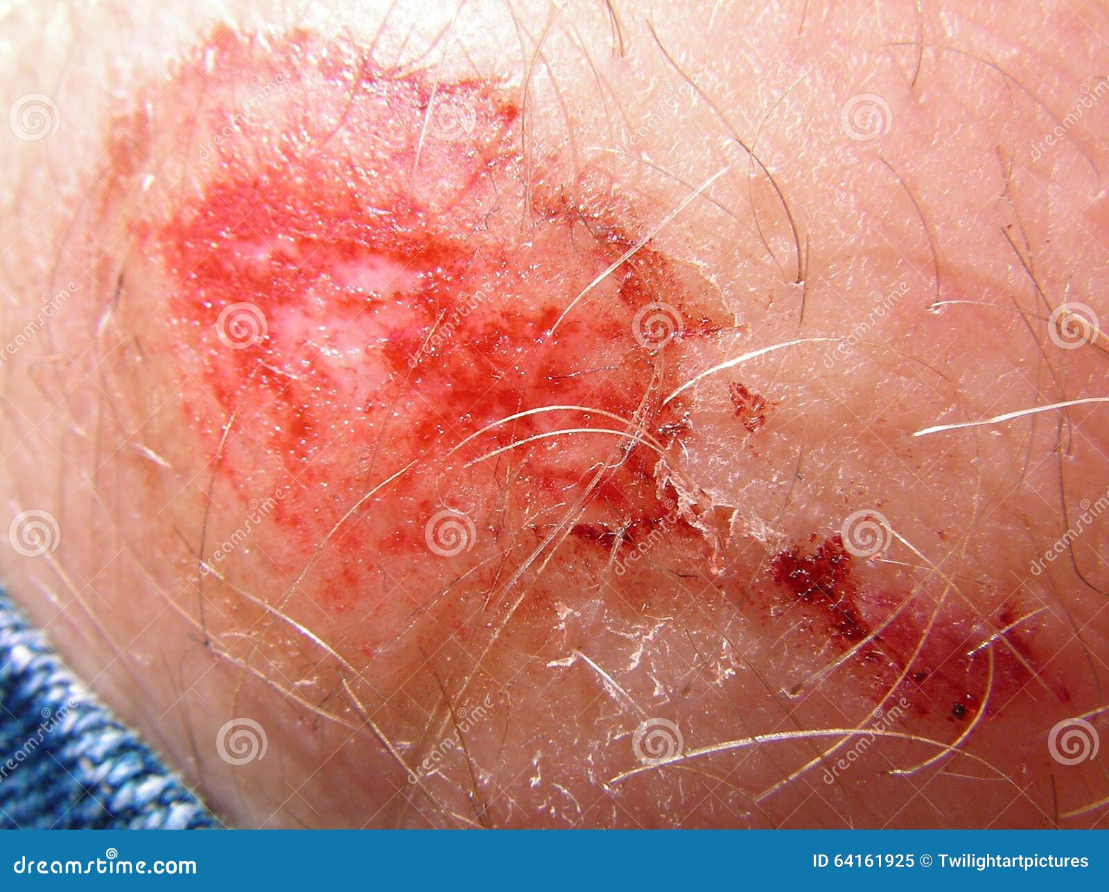 Graze on His Knee from a Young Child Stock Image - Image of childlike ...