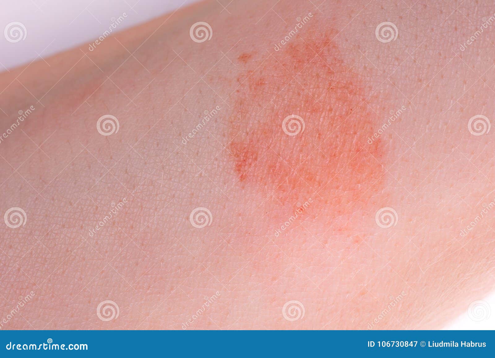 The Great Red Spot on the Skin Closeup Stock Image - Image of medicine ...