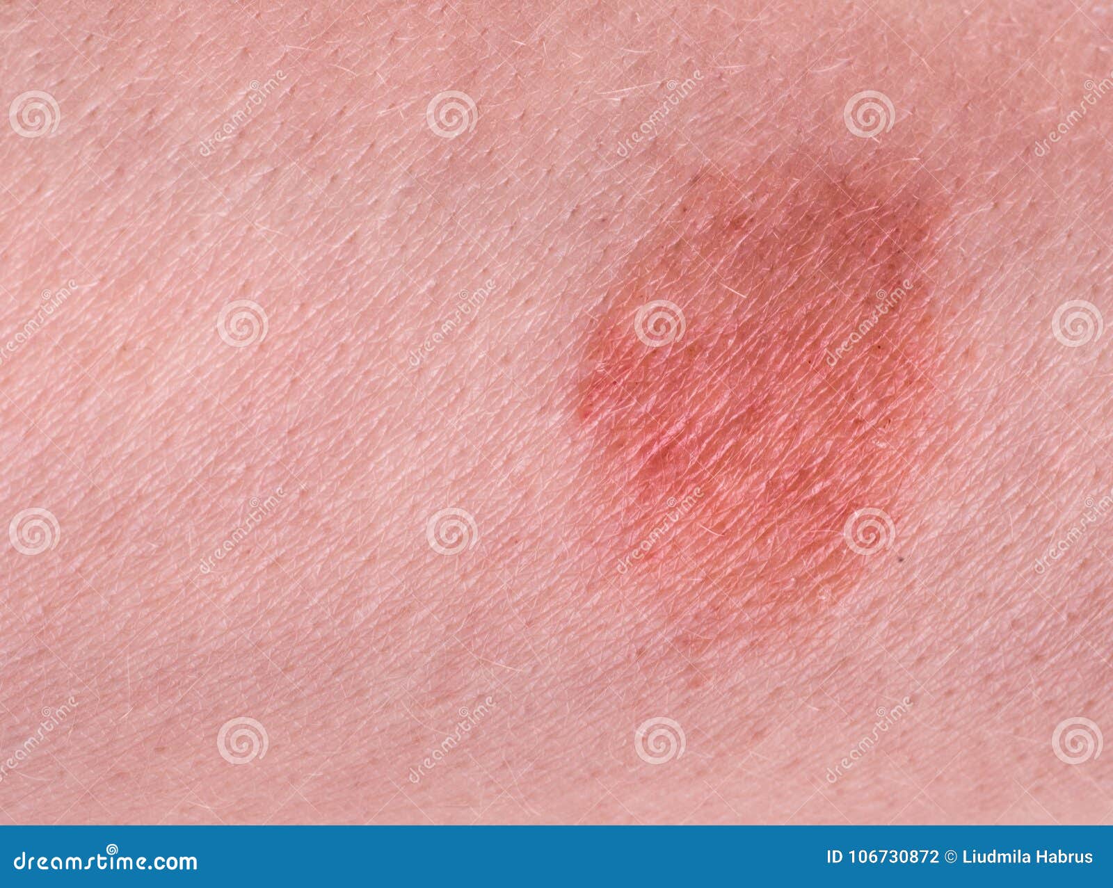 The Great Red Spot on the Skin Closeup Stock Photo - Image of closeup ...