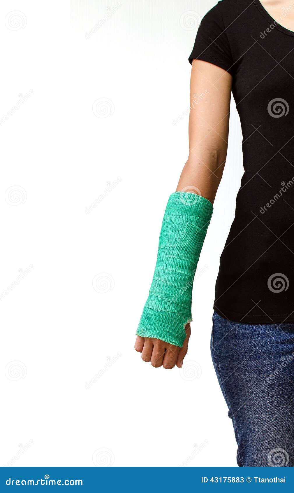 Green Cast on Hand and Arm Isolated on White Background Stock Image ...