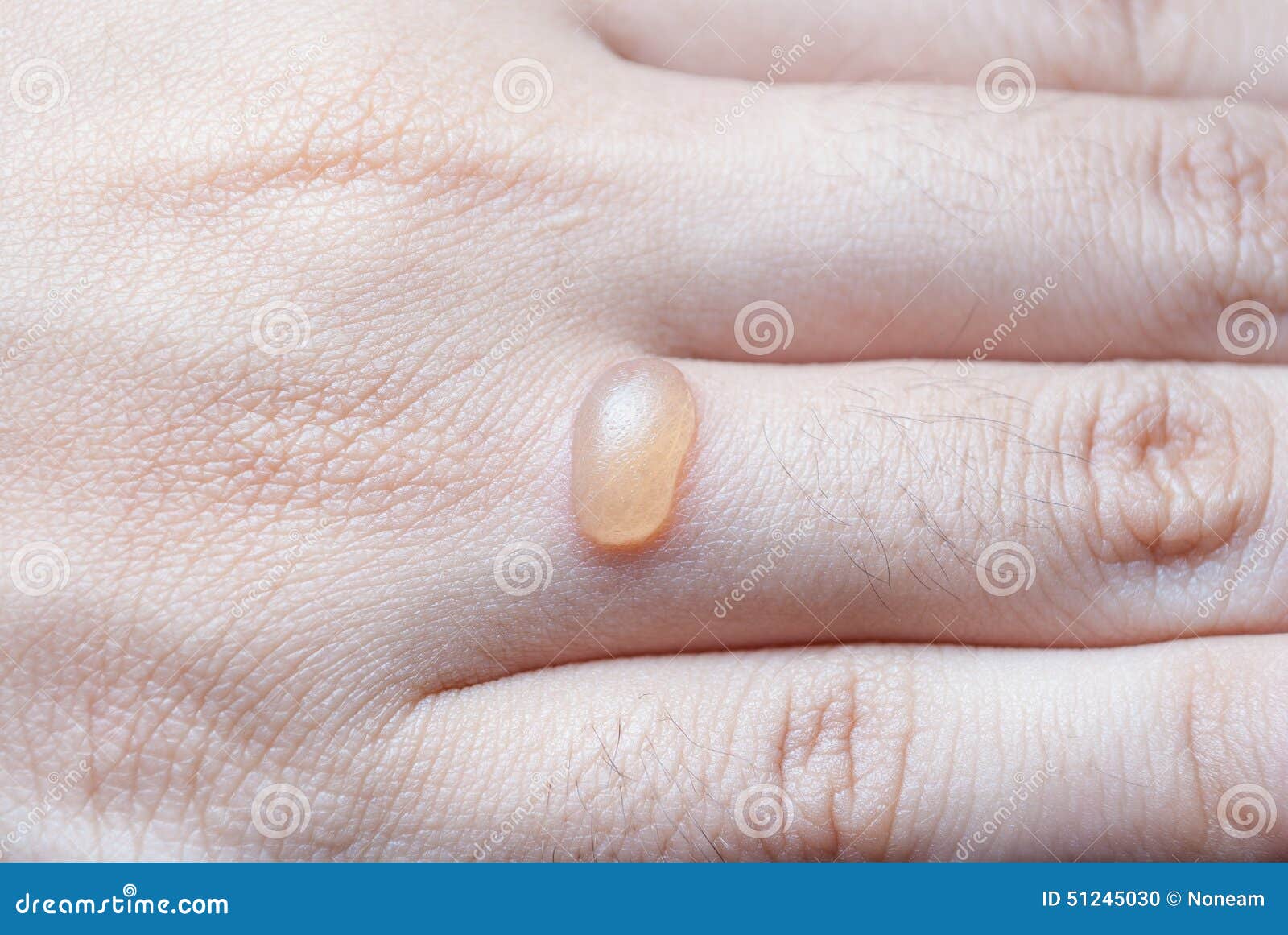 Grote Blaar Op Menselijke Vinger Stock Foto - Image of vinger ...