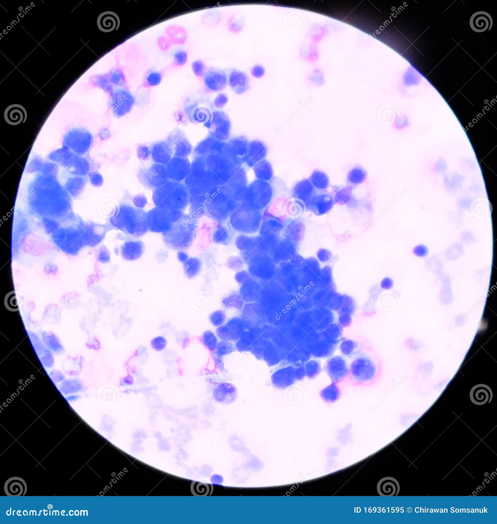 Abnormal Cell in Plural Fluid Find with Microscope Stock Image - Image ...