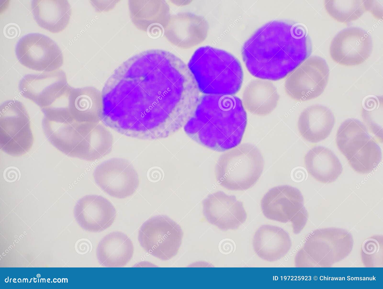 Blast Cells On Red Blood Cells Background Stock Photo | CartoonDealer ...