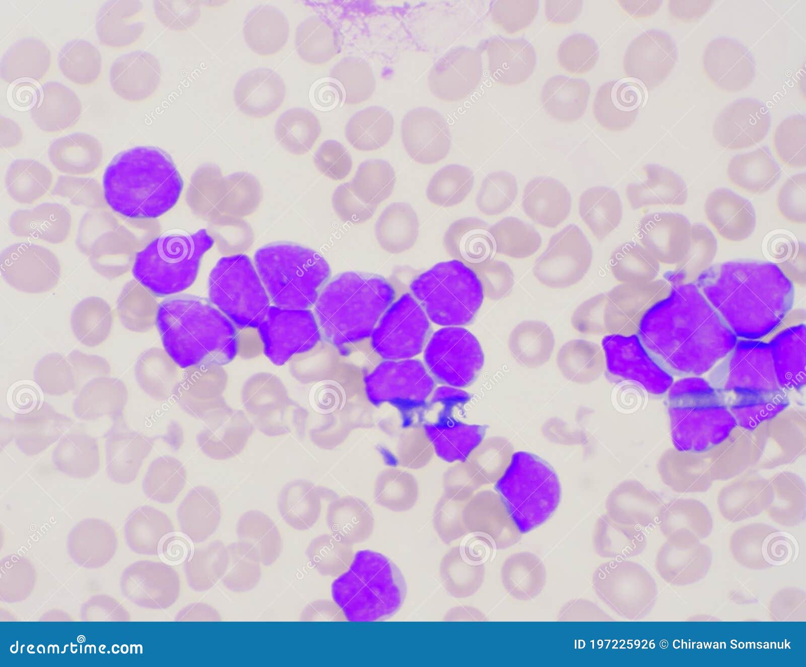 Blast Cells On Red Blood Cells Background Stock Photo | CartoonDealer ...