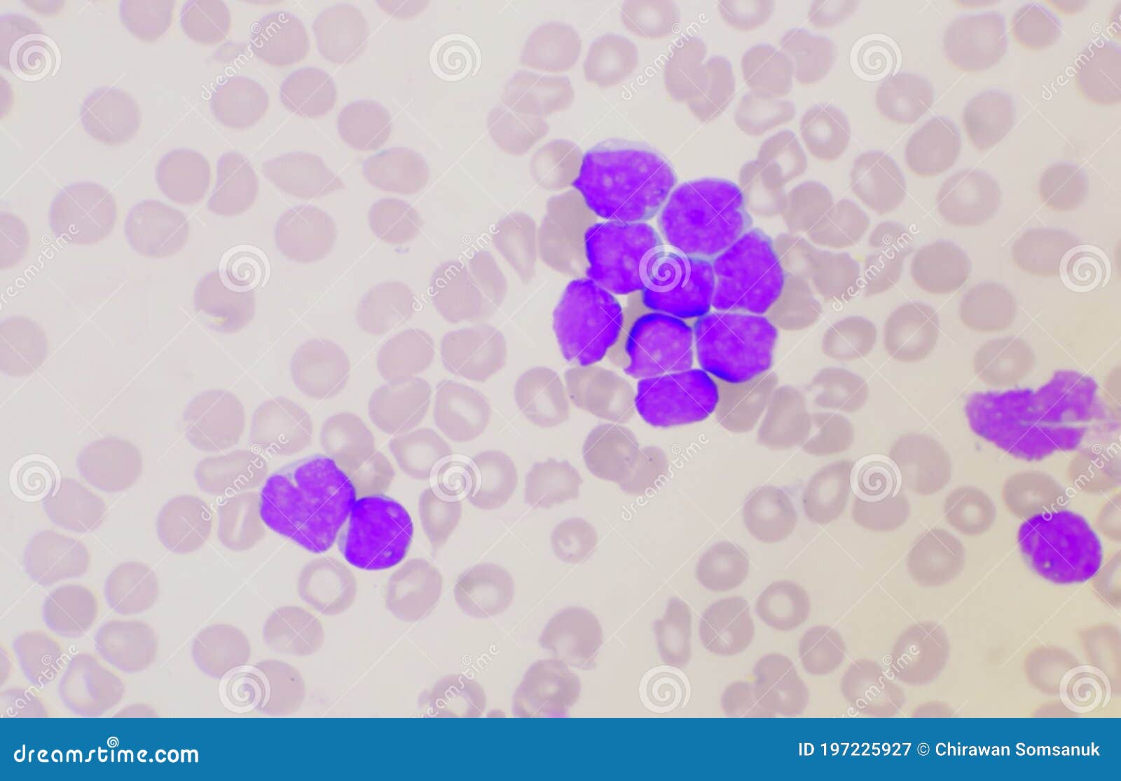 Group of Blast Cells in Leukemia Background Stock Image - Image of ...