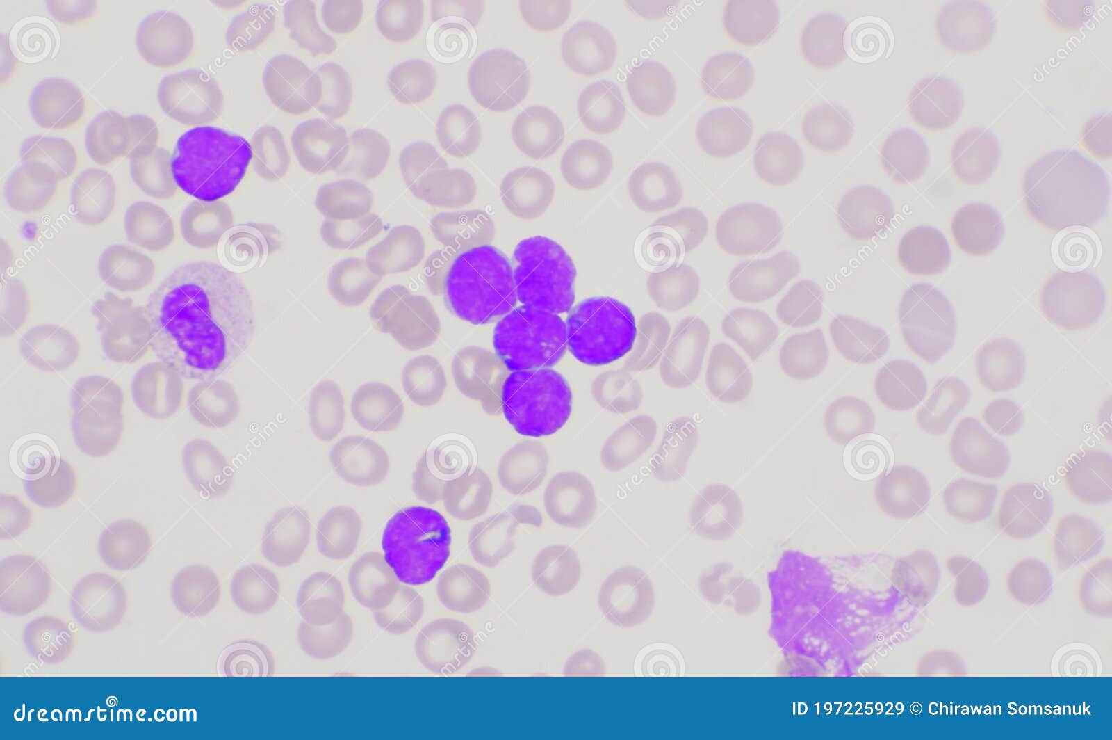 Blast Cells On Red Blood Cells Background Stock Photo | CartoonDealer ...