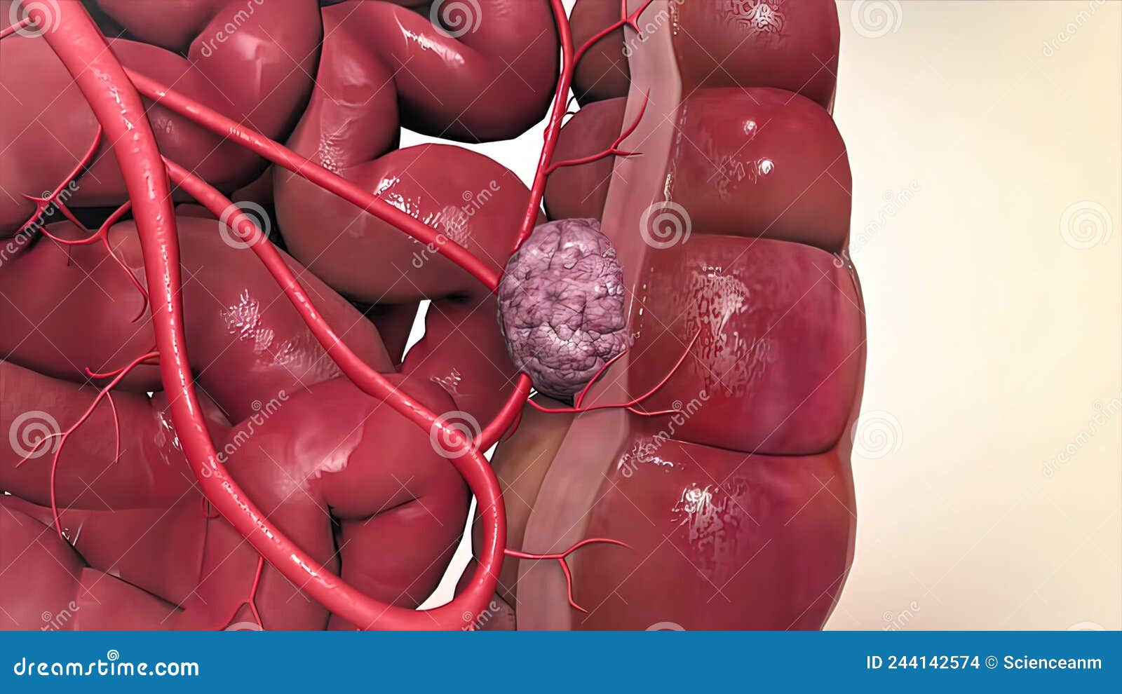 The Growth that Develops Inside the Colon is the Name Given To the ...