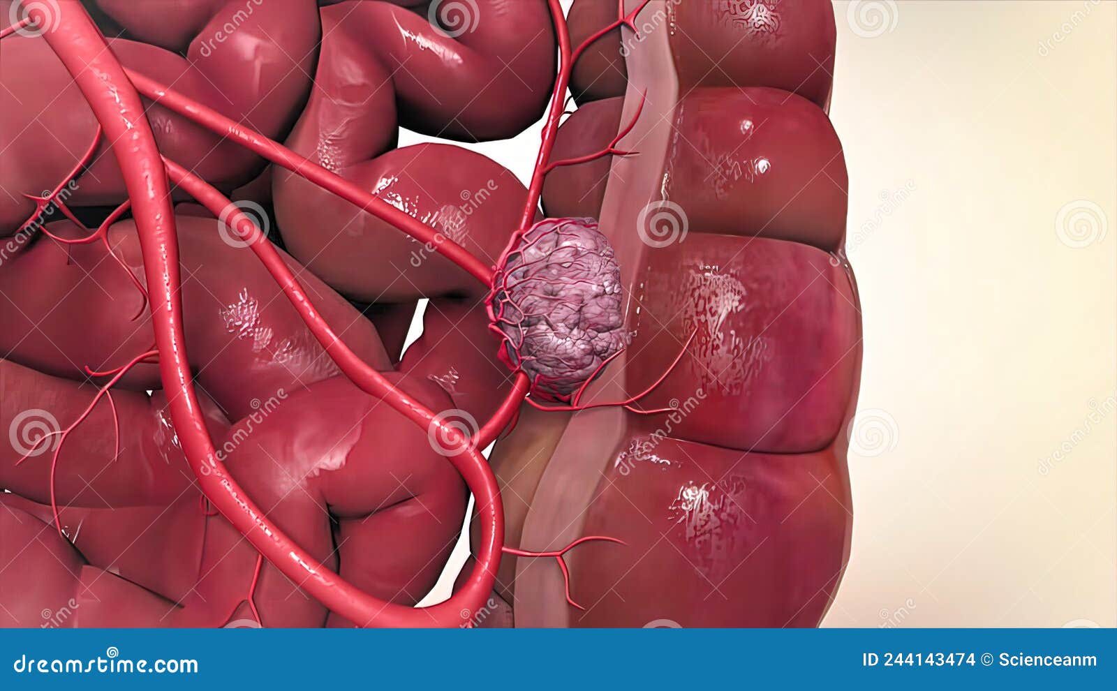 The Growth that Develops Inside the Colon is the Name Given To the ...