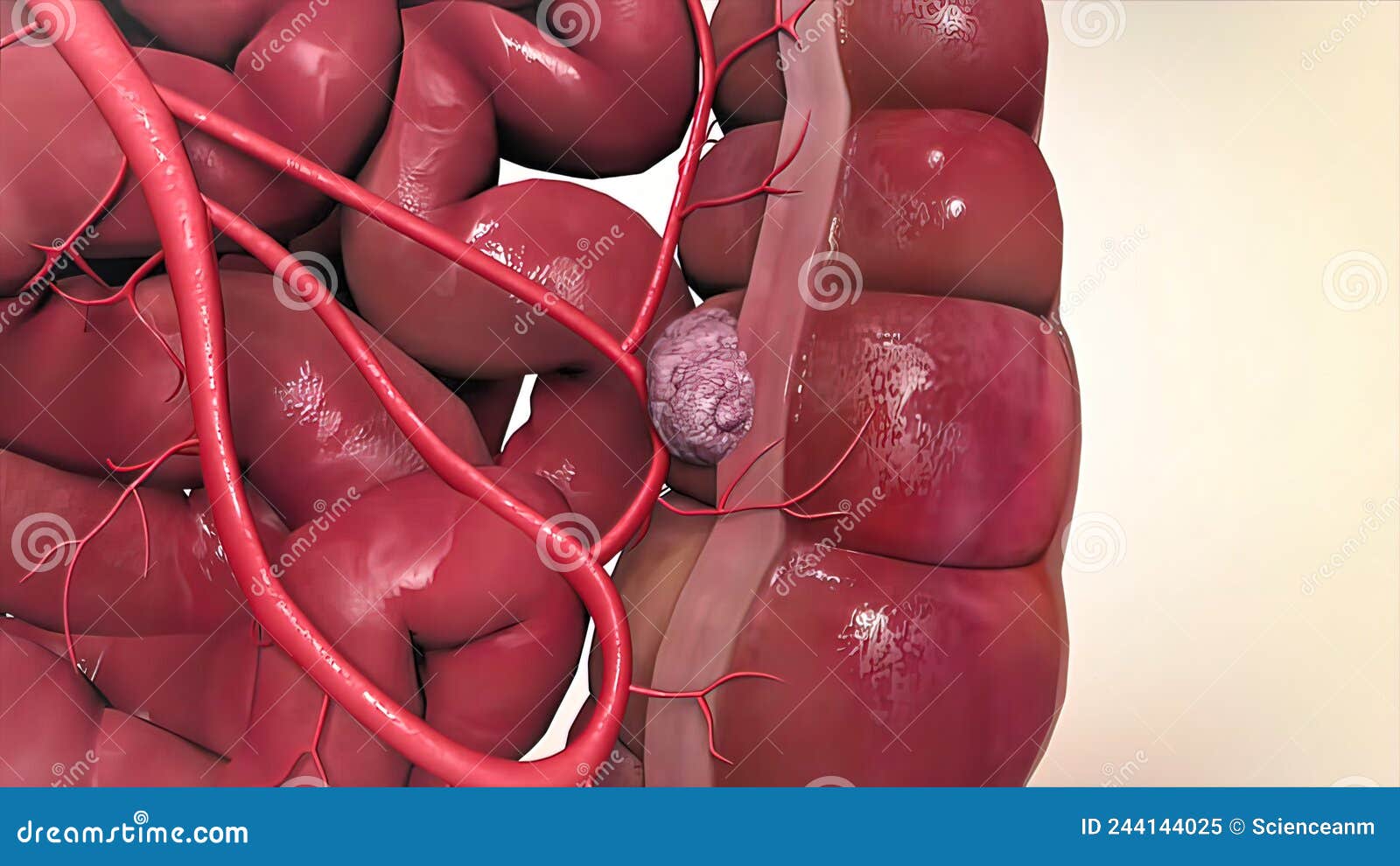 The Growth that Develops Inside the Colon is the Name Given To the ...