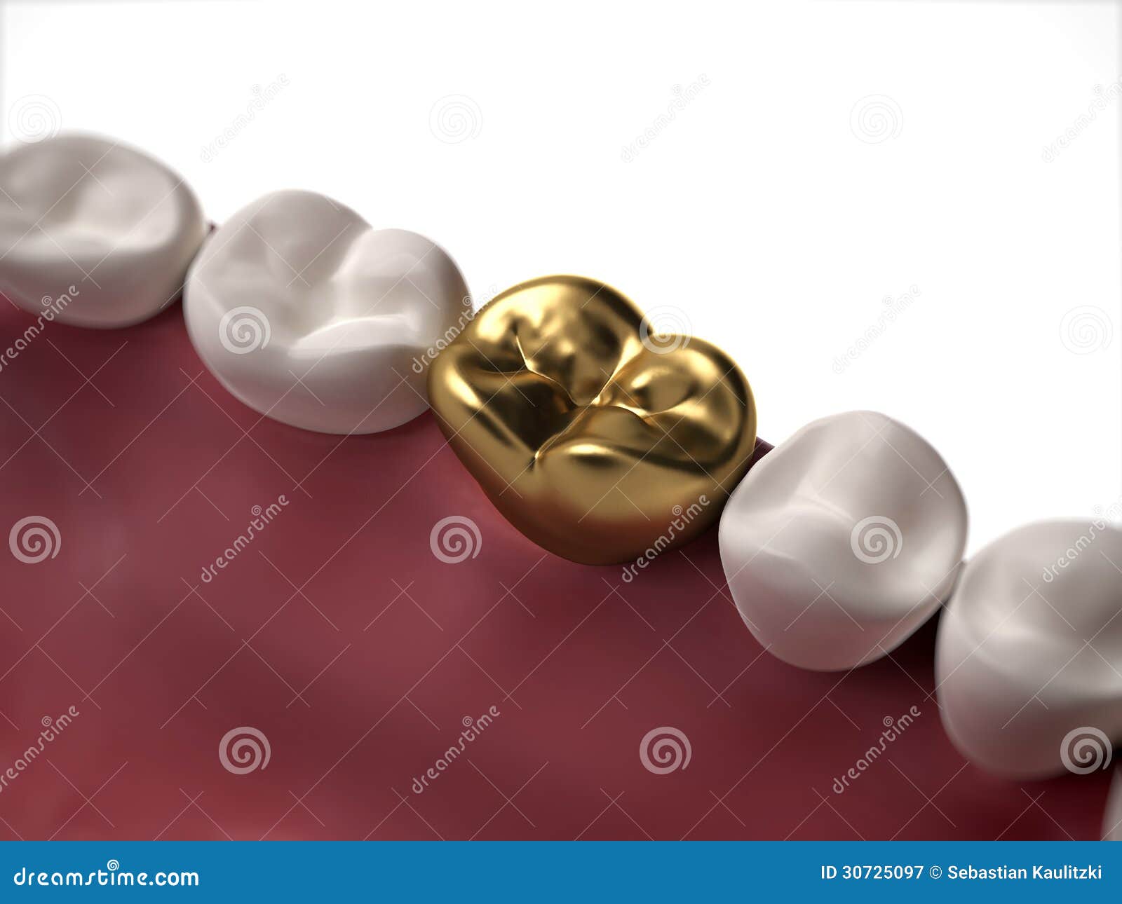 Guld- tand stock illustrationer. Illustration av ortodontisk - 30725097