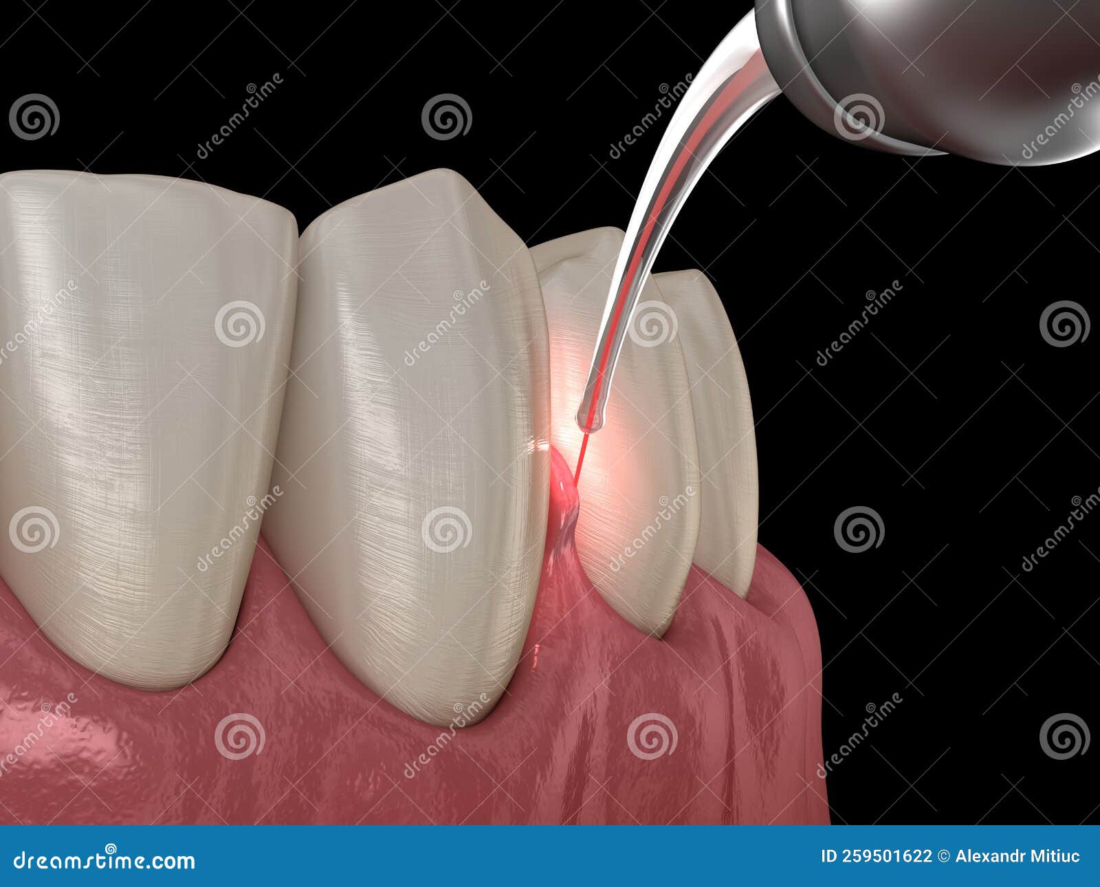 Gum Correction Surgery with Laser. Medically Accurate Tooth 3D ...