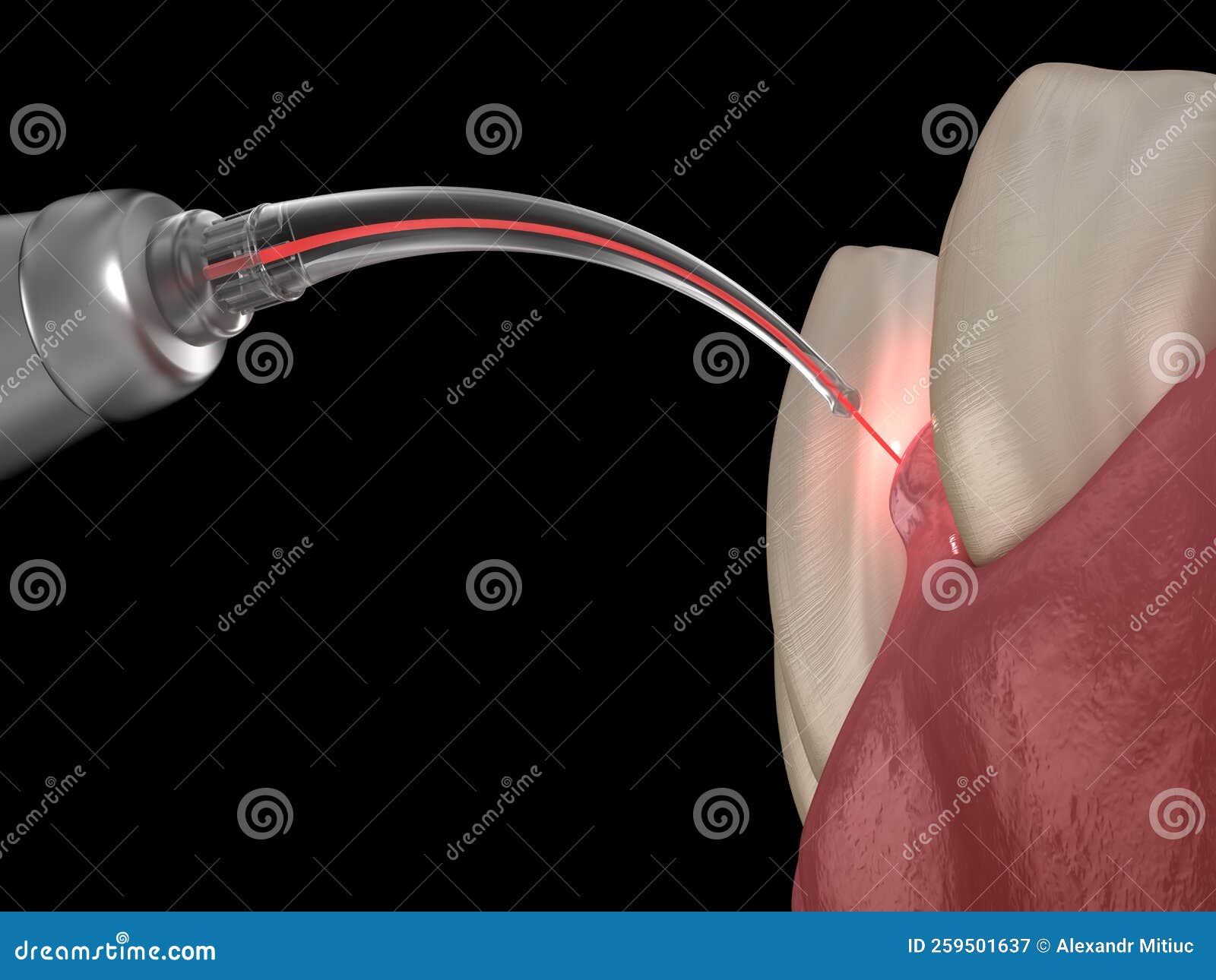 Gum Correction Surgery with Laser. Medically Accurate Tooth 3D ...