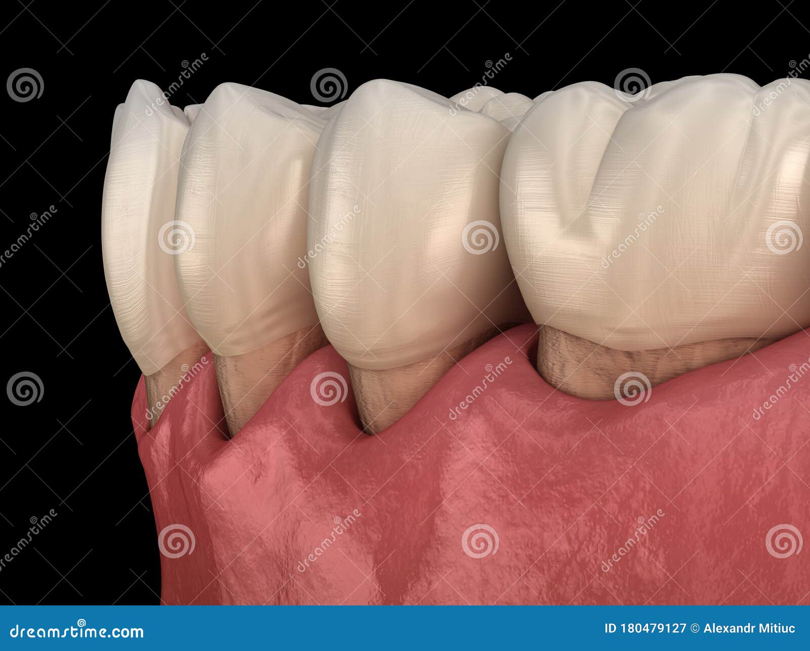 Gum Recession Process. Medically Accurate Illustration Stock ...