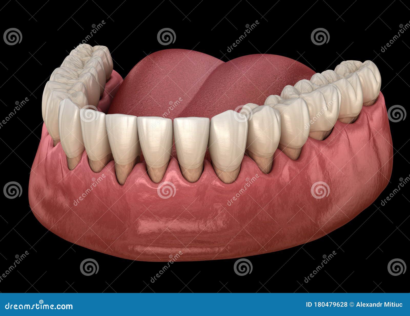 Gum Recession Process. Medically Accurate Illustration Stock ...