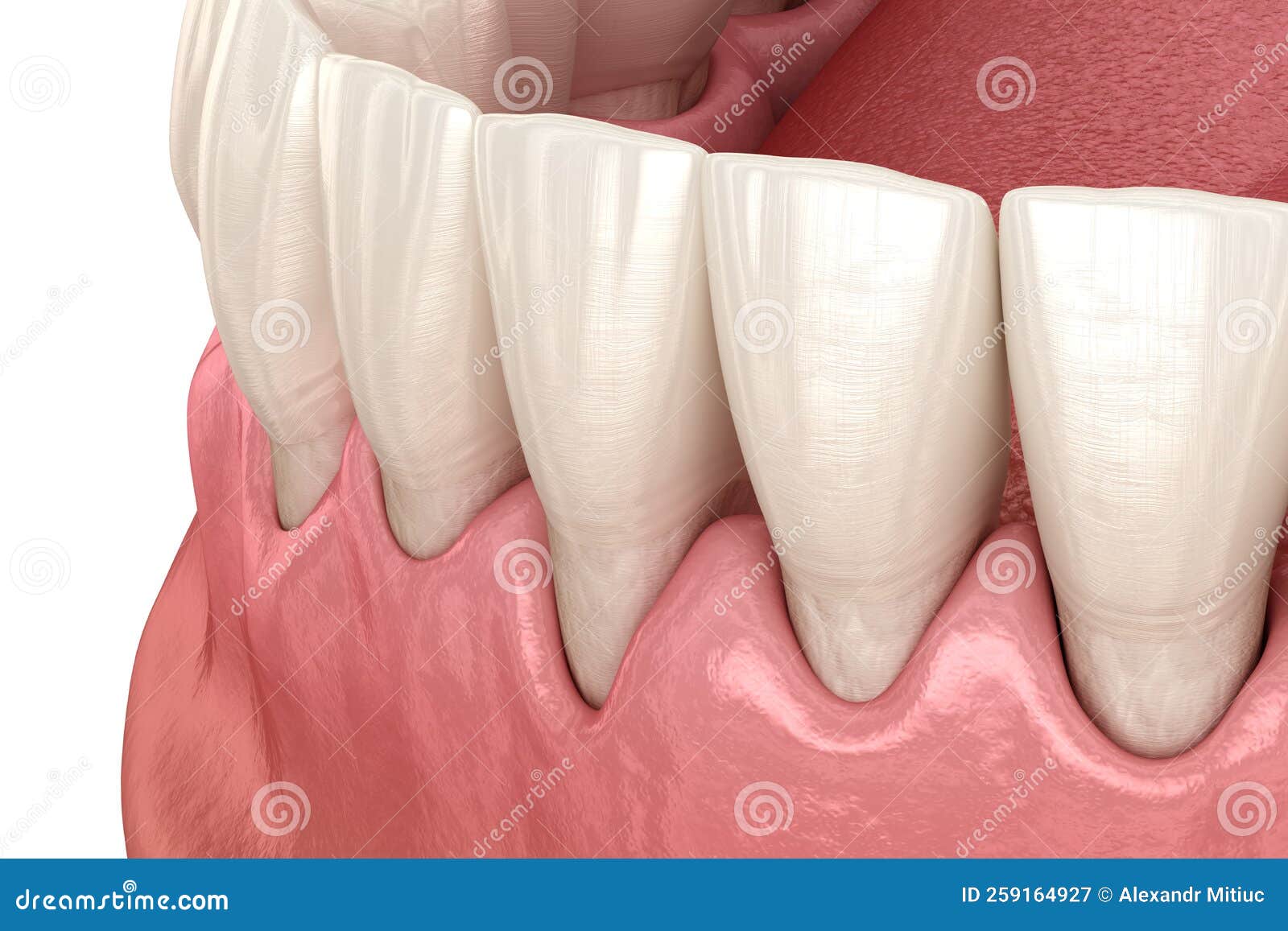 Gum Recession Process. Medically Accurate 3D Illustration Stock ...
