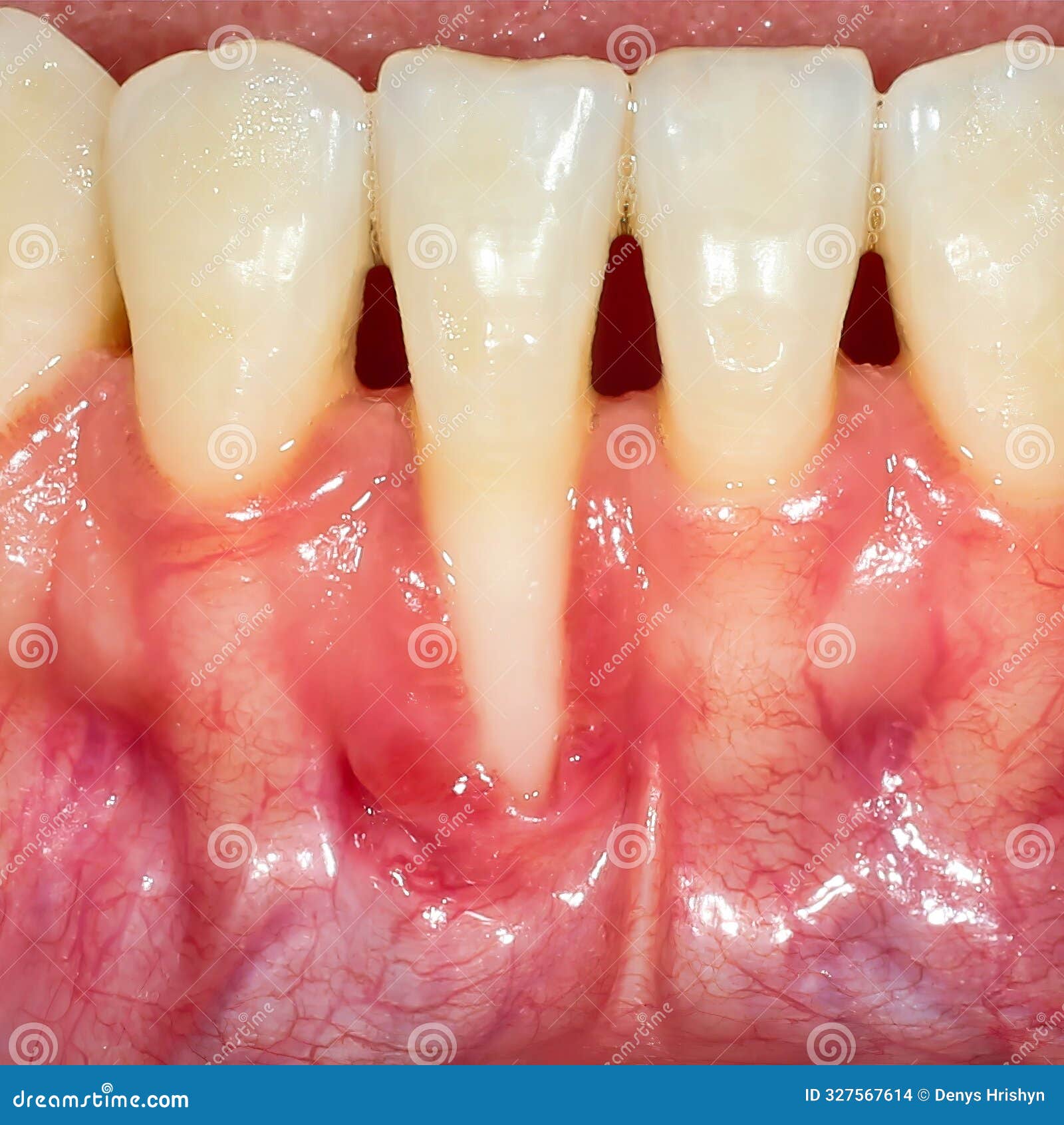 Gum Recession and Tooth Discoloration Stock Photo - Image of healthy ...