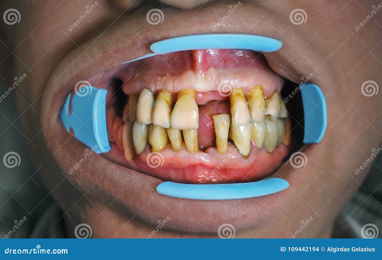 Gums and Tooth Structure Have Been Worn Away Leading To Exposed Stock ...