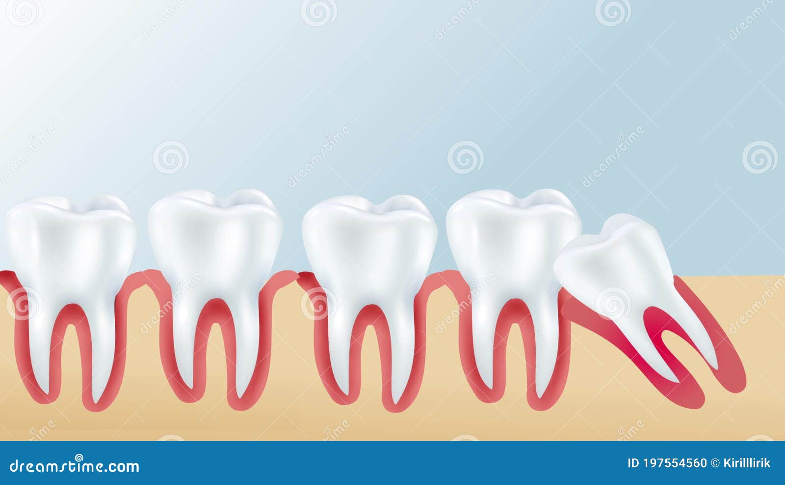 Gums with Wisdom Tooth Mesial Causing Crowding. Problems Caused by ...
