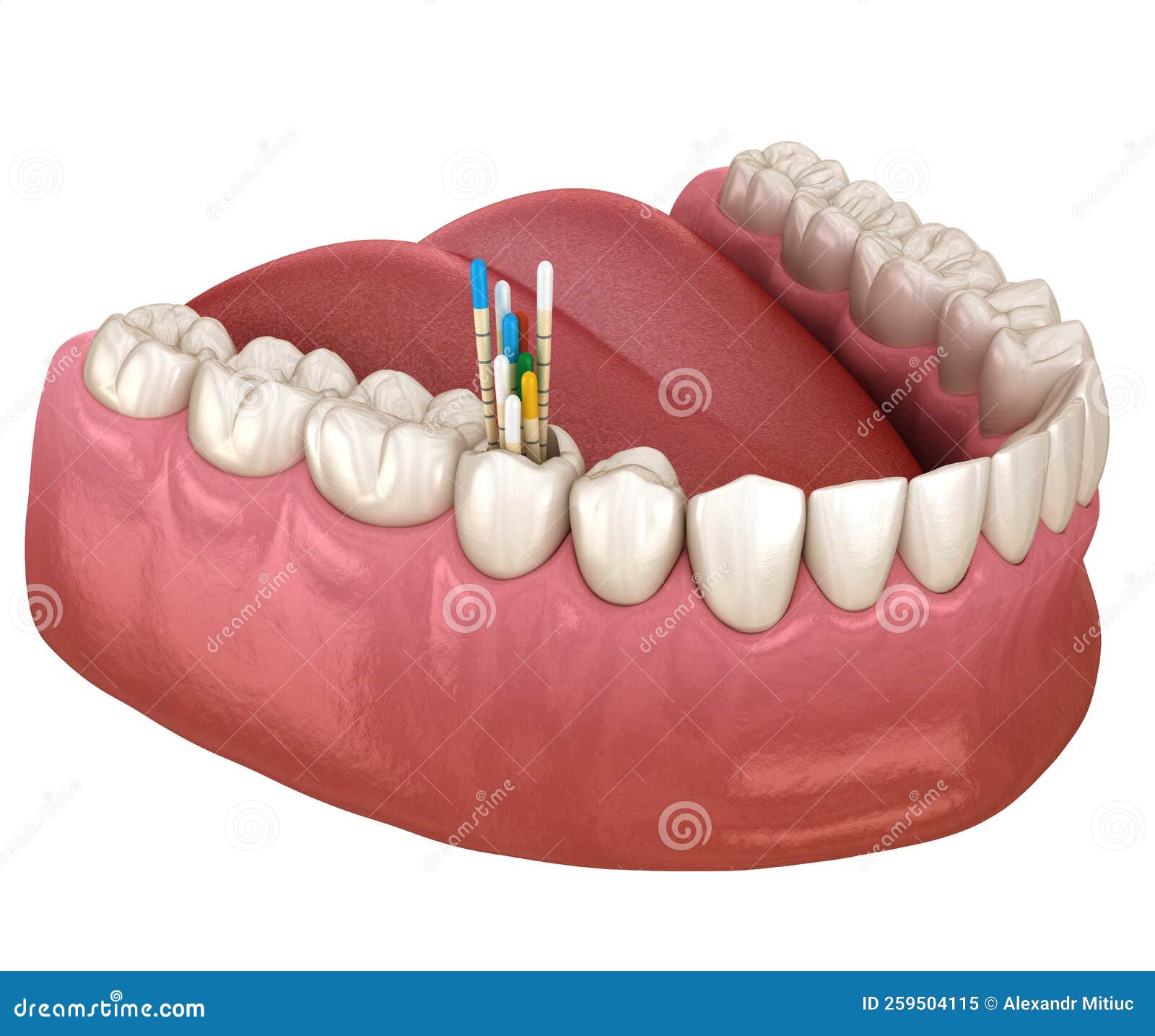 Gutta Percha Root Canal Treatment Process. Medically Accurate Tooth 3D ...