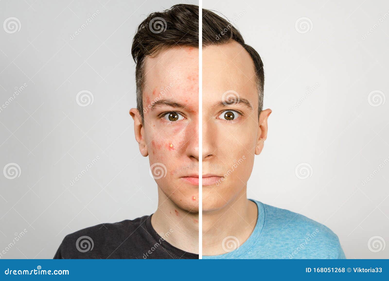 Two Guys before-after: Left Guy with Acne, Red Spots, Problem Skin ...