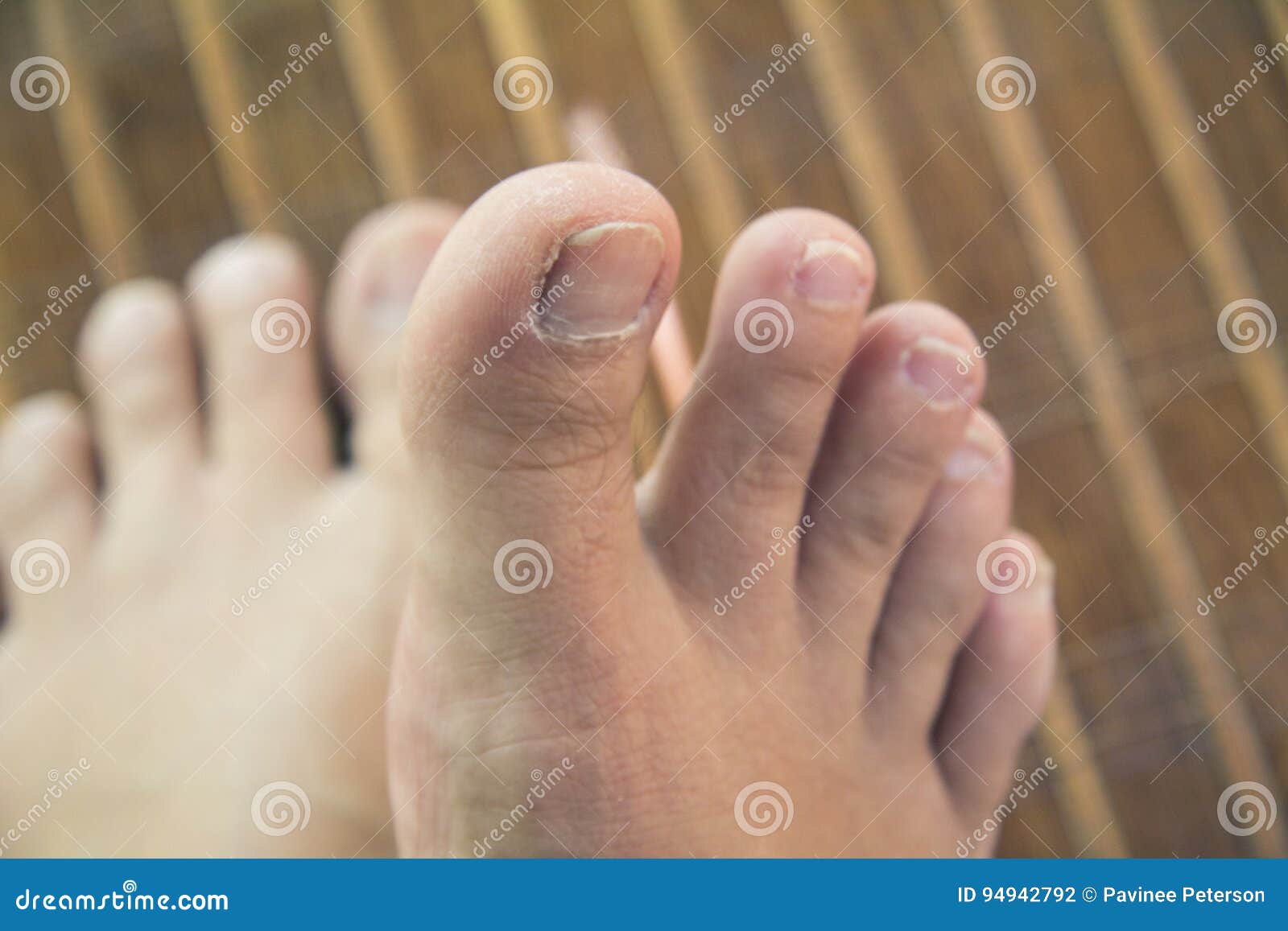 Hässliche Füße stockfoto. Bild von menschlich, zehe, namen - 94942792