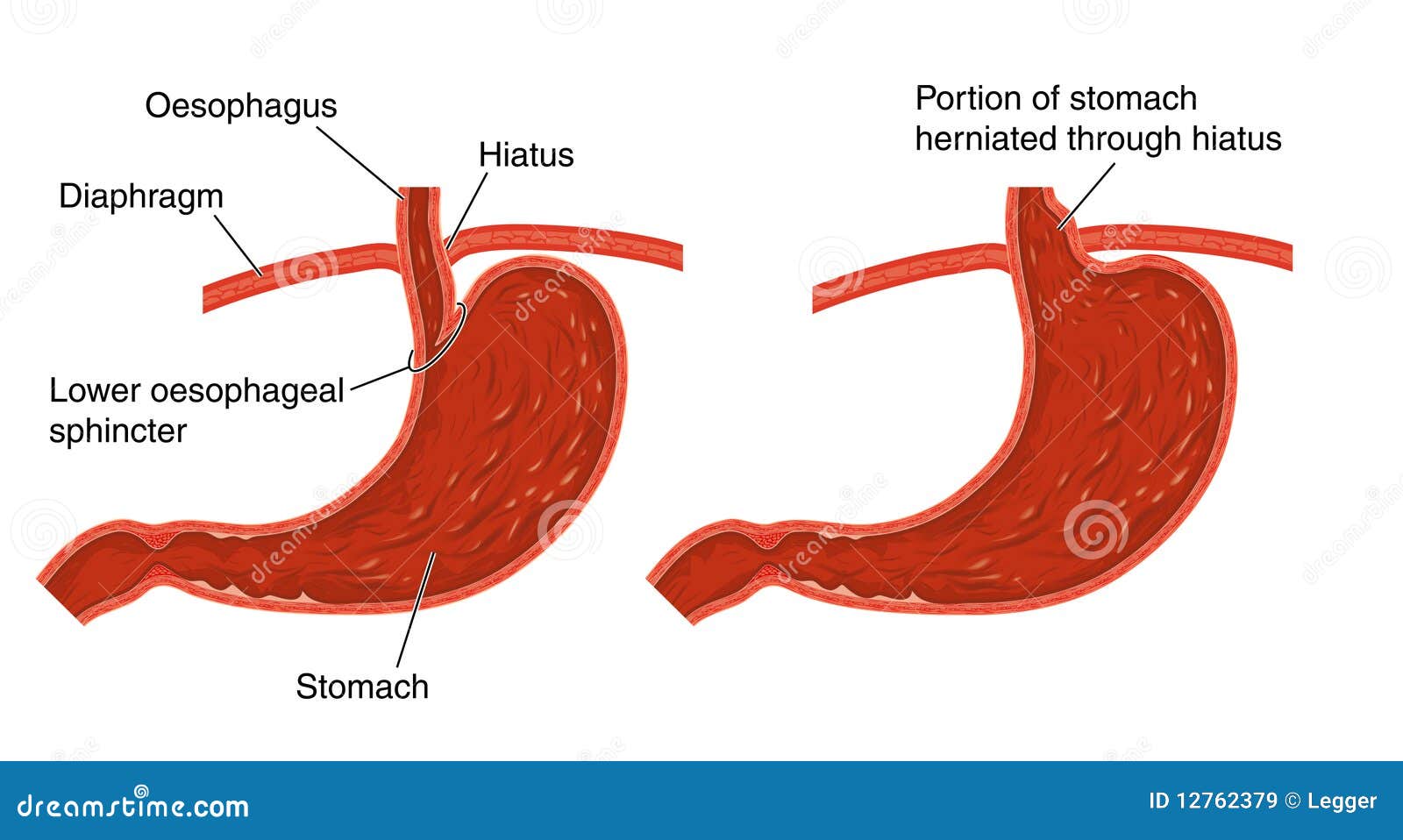 Hérnia do hiato ilustração do vetor. Ilustração de esôfago - 12762379