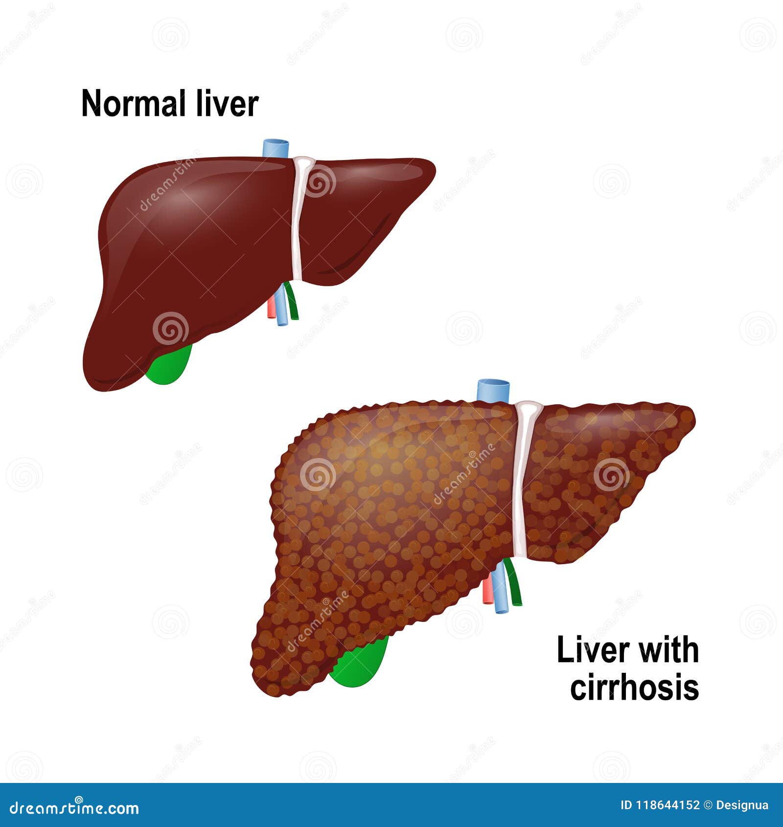 Hígado Normal Y Hígado Con Cirrosis Ilustración del Vector ...