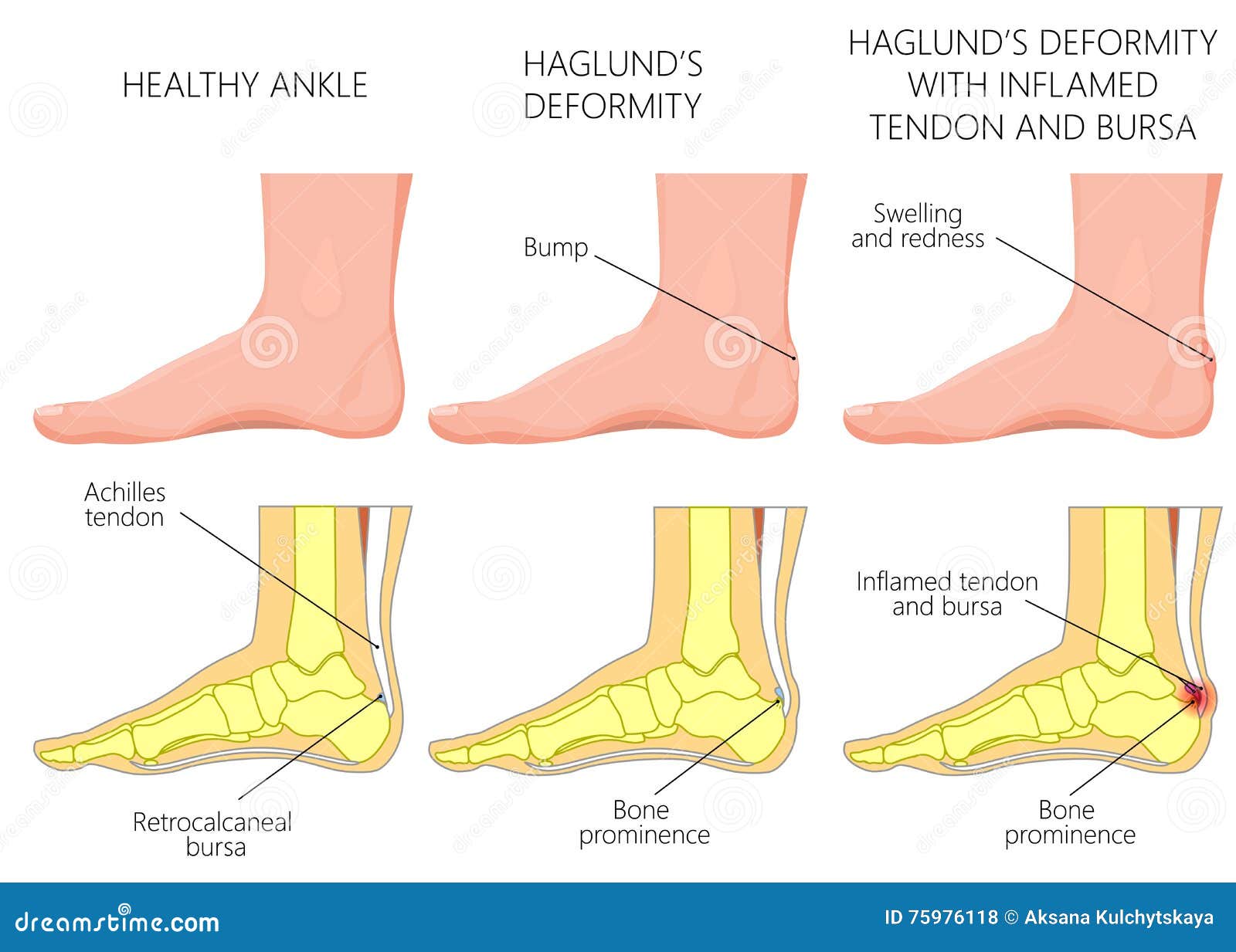 Haglunds Missbildung vektor abbildung. Illustration von sport - 75976118