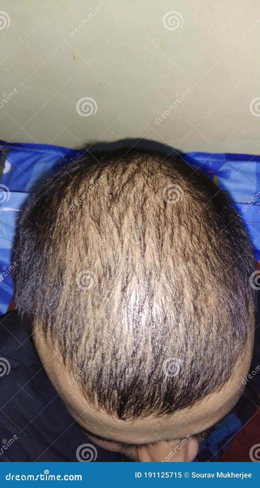 Less Hair In Head Density Of Hair Is Very Low Stock Image Image Of Distant Hair 191125715