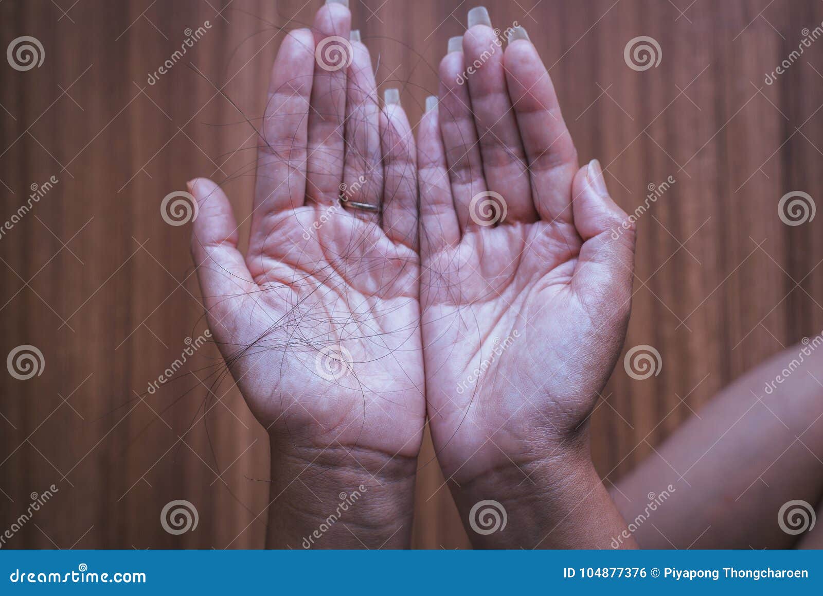 Hair Loss on Hand Problem for Health Care Stock Photo - Image of skin ...
