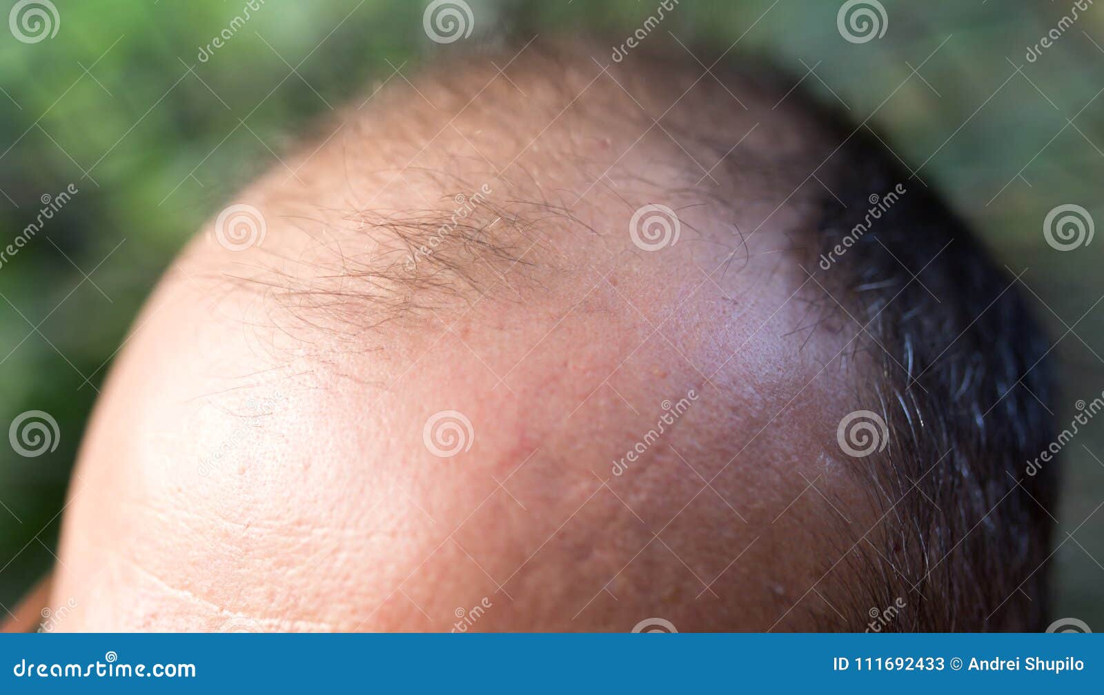Hair Loss on the Head of a Man Stock Image - Image of medicine, person ...