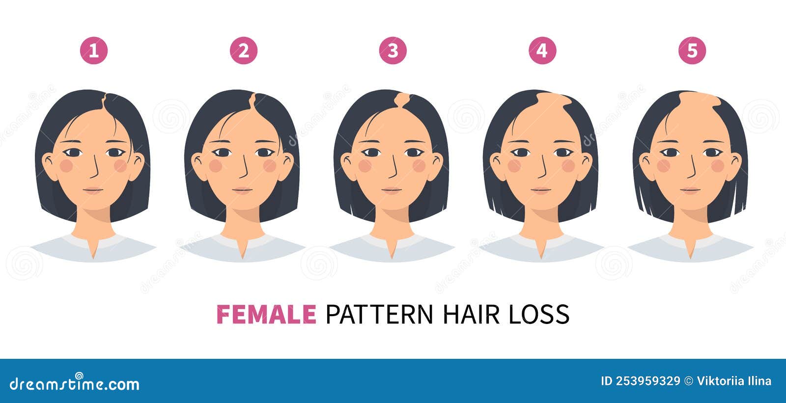 Alopecia Stages Set Female Balding In Process Vector Illustration