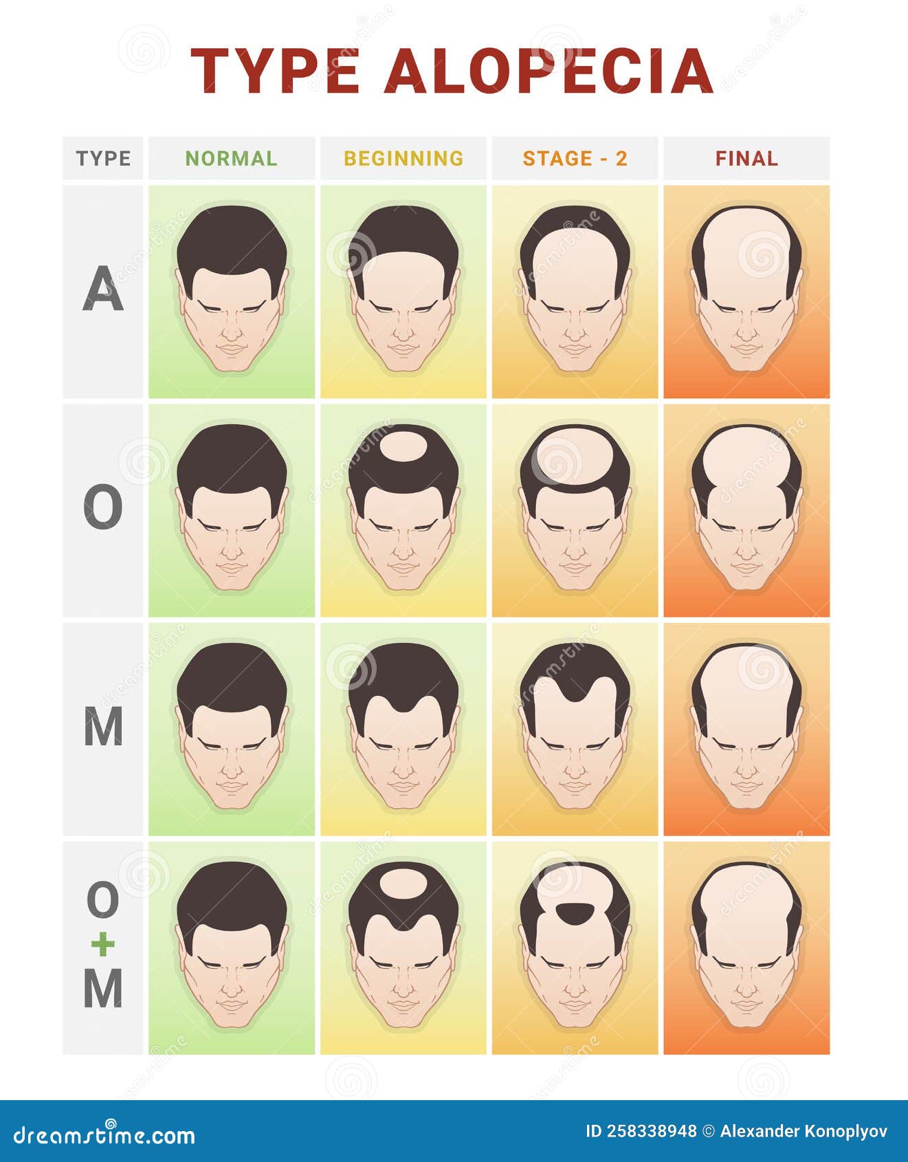 Hair Loss Stages Infographic Medical Education Scheme Vector Flat