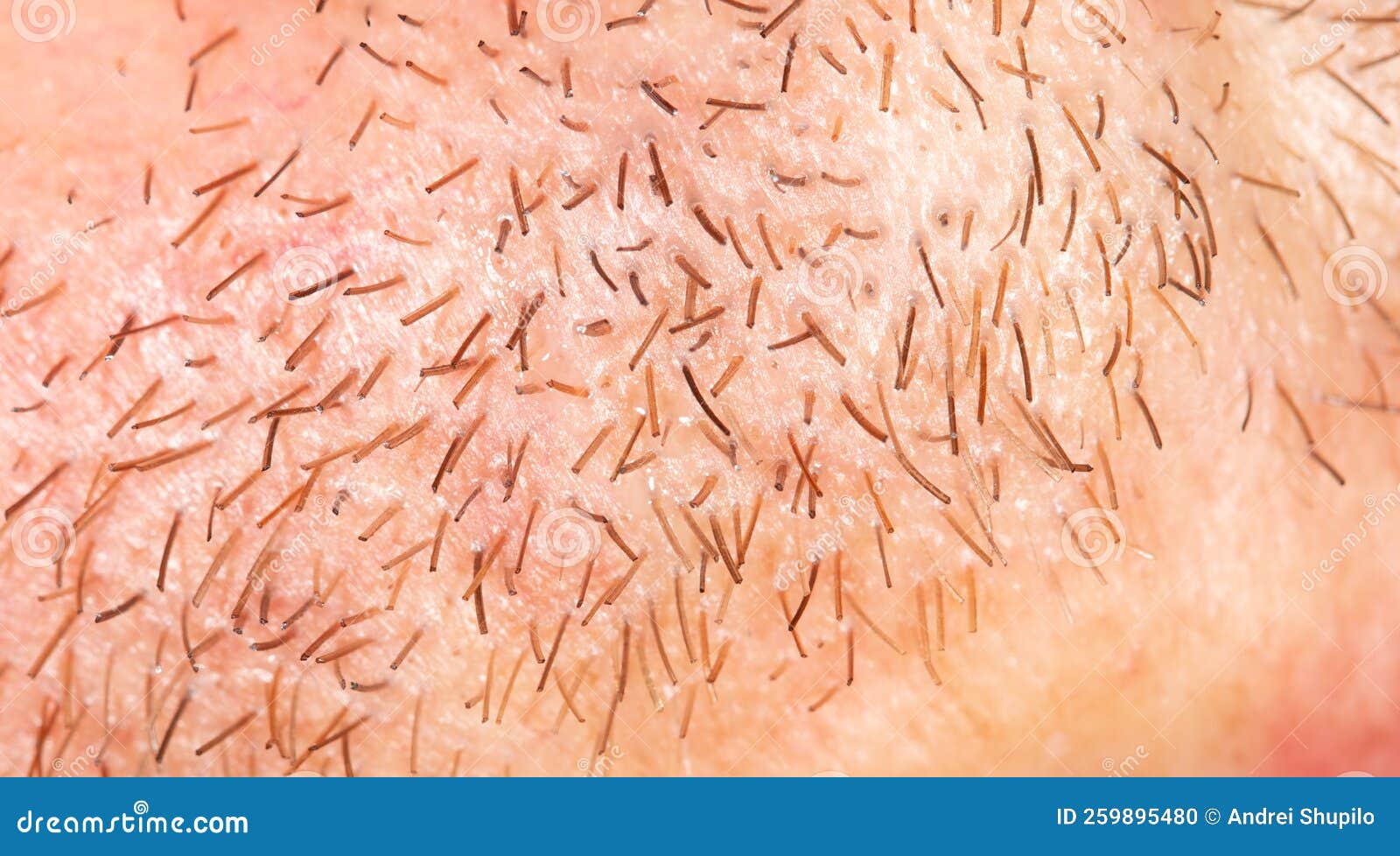 Hair on the Skin of a Man S Face. Macro Stock Photo - Image of healthy ...