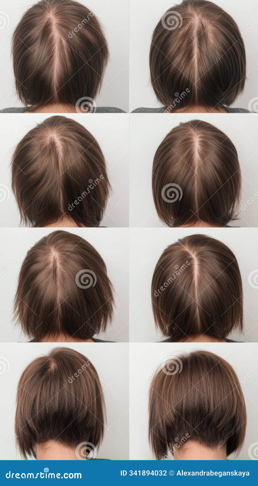 Hair Thinning Progression Stages in Adult Stock Illustration ...