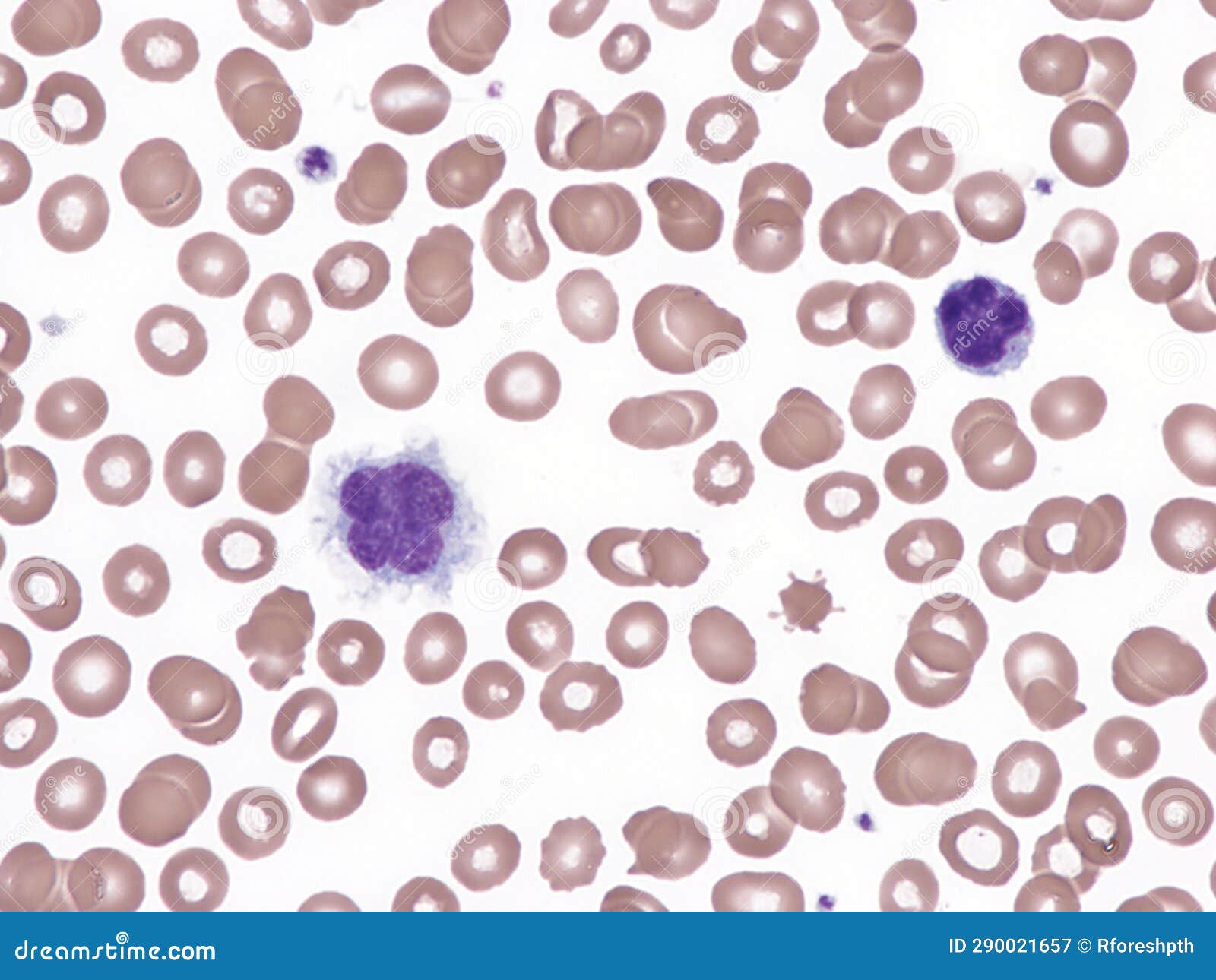 Hairy cell leukemia. stock image. Image of cell, wright - 290021657