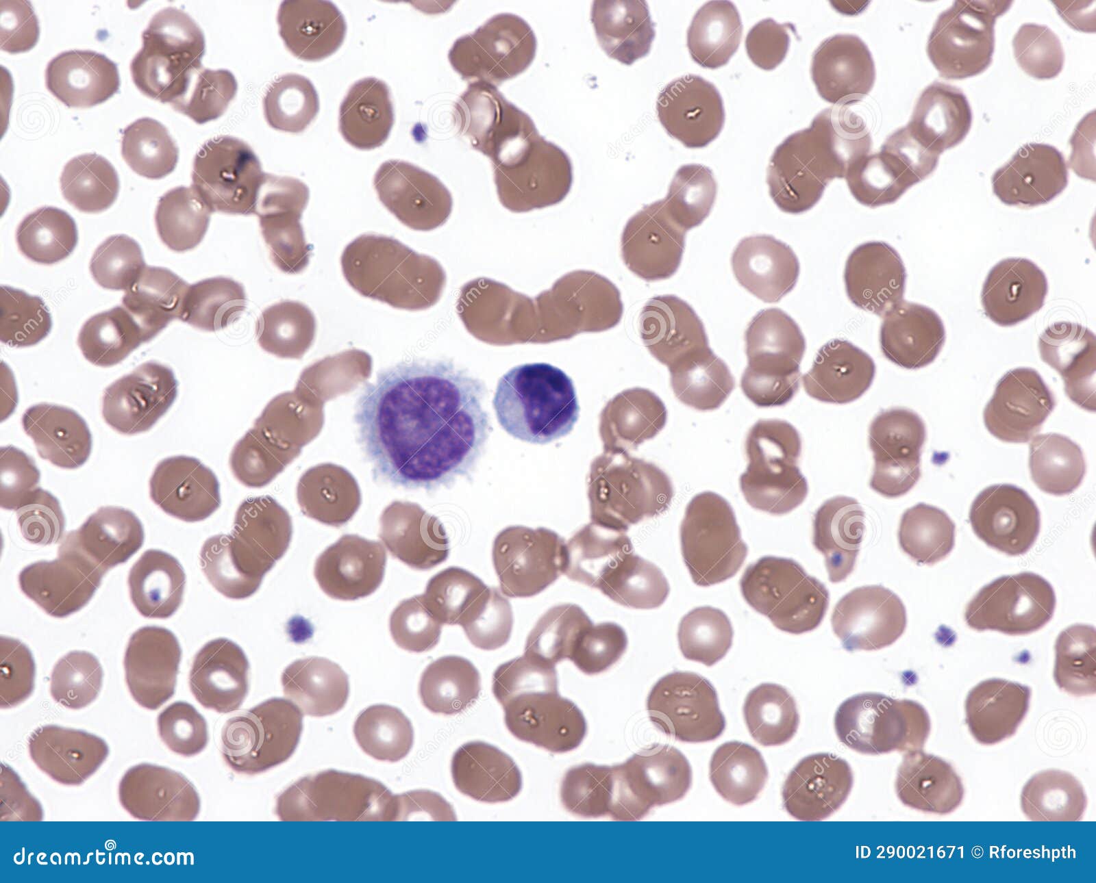 Hairy cell leukemia. stock image. Image of clinical - 290021671