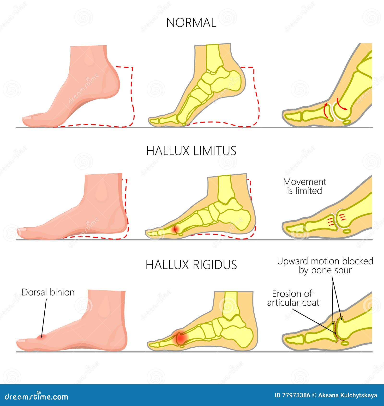 Hallux rigidus stock vector. Illustration of arthritis - 77973386