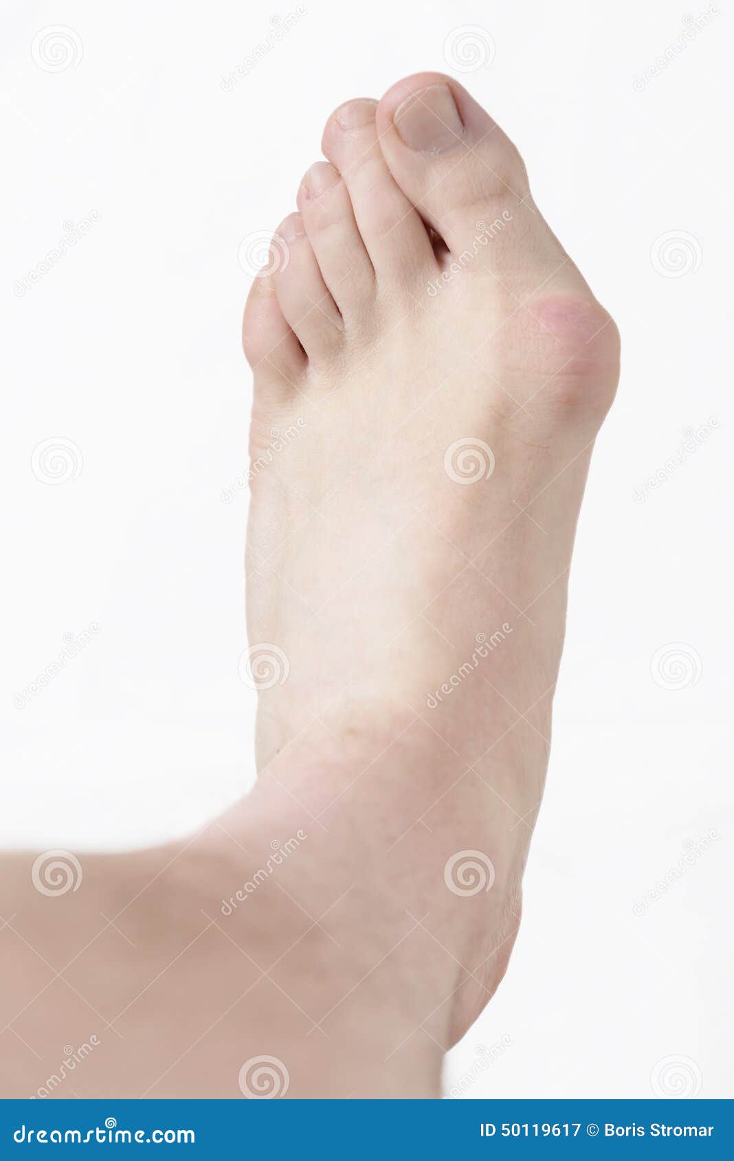 Hallux Valgus Orthopedic Pads On Thumb Toes. Bunion Deformity Of The ...