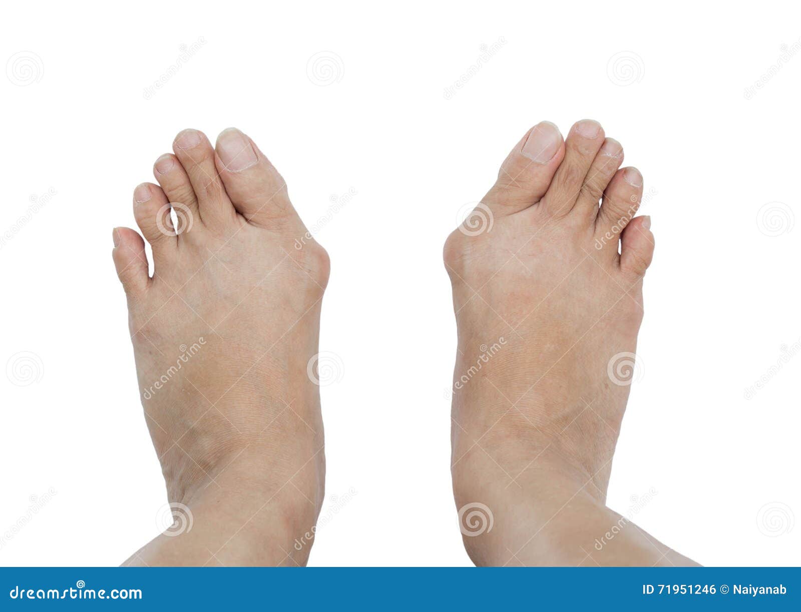 Hallux Valgus Orthopedic Pads On Thumb Toes. Bunion Deformity Of The ...