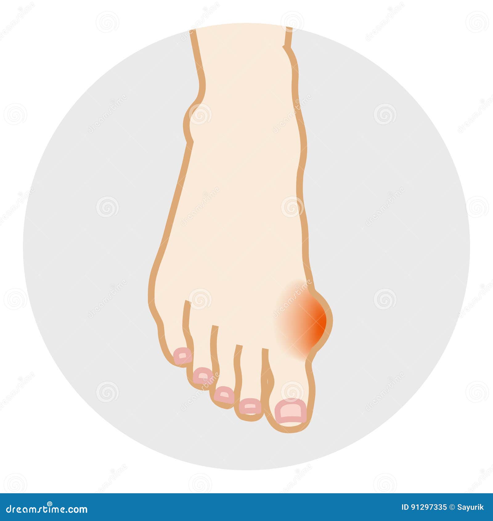 Hallux Valgus - Foot Body Part Stock Vector - Illustration of medical ...
