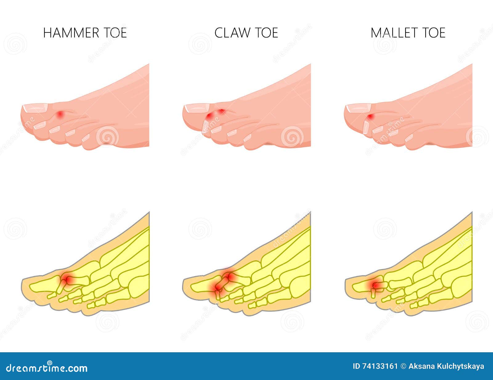 Hammer_claw_mallet_toe vektor abbildung. Illustration von diagnose ...