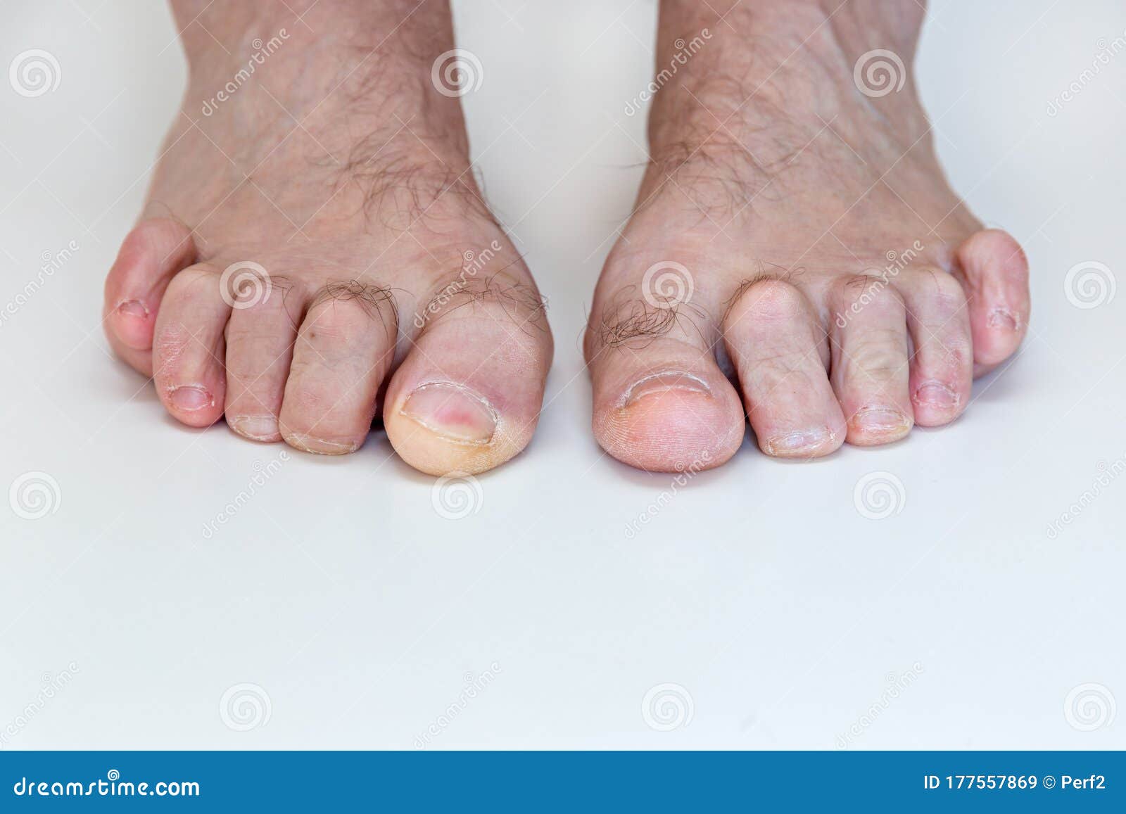 Hammer toe feet stock image. Image of deformation, shank - 177557869